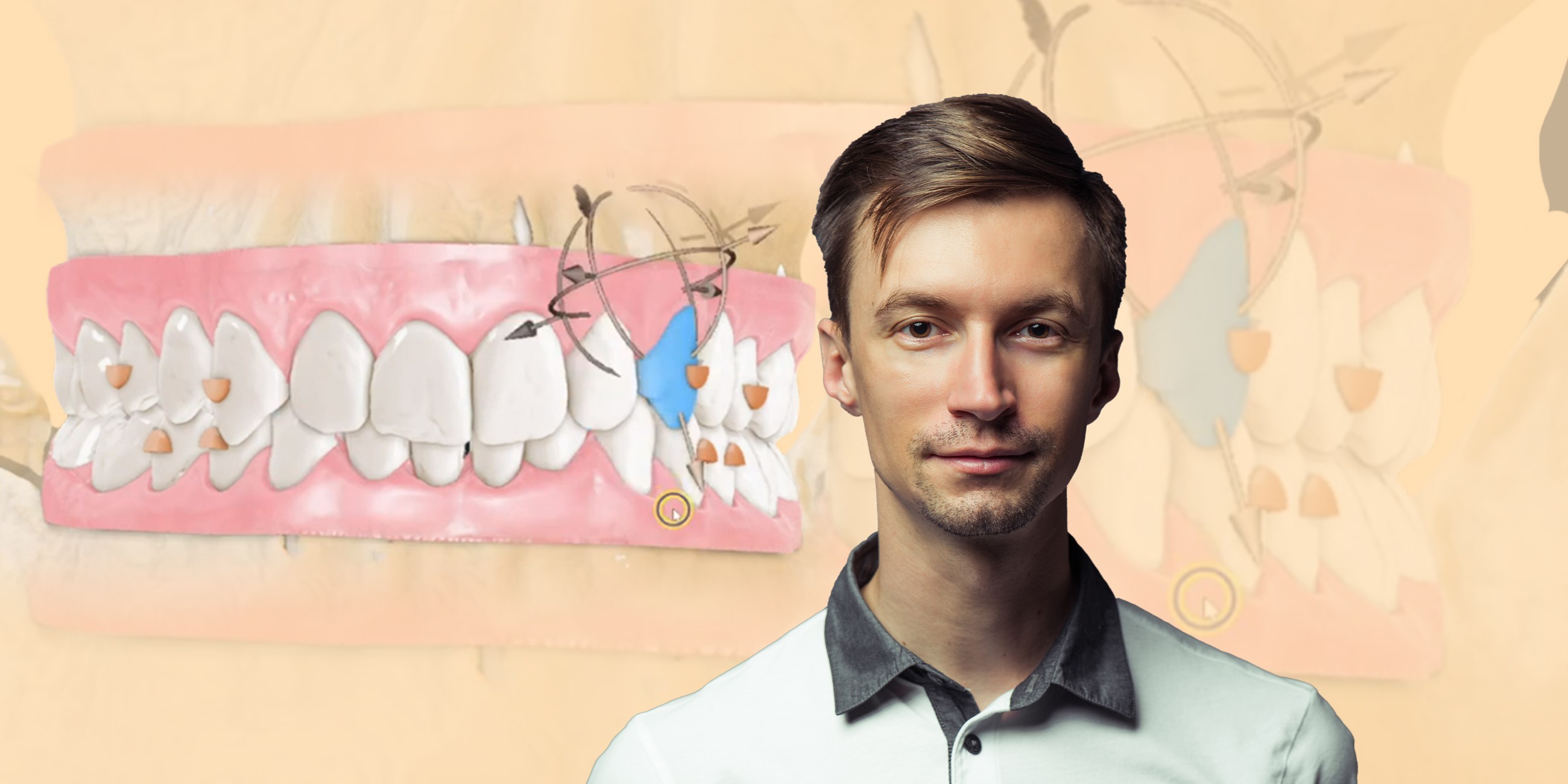 Mesial-distal movements with clear aligners