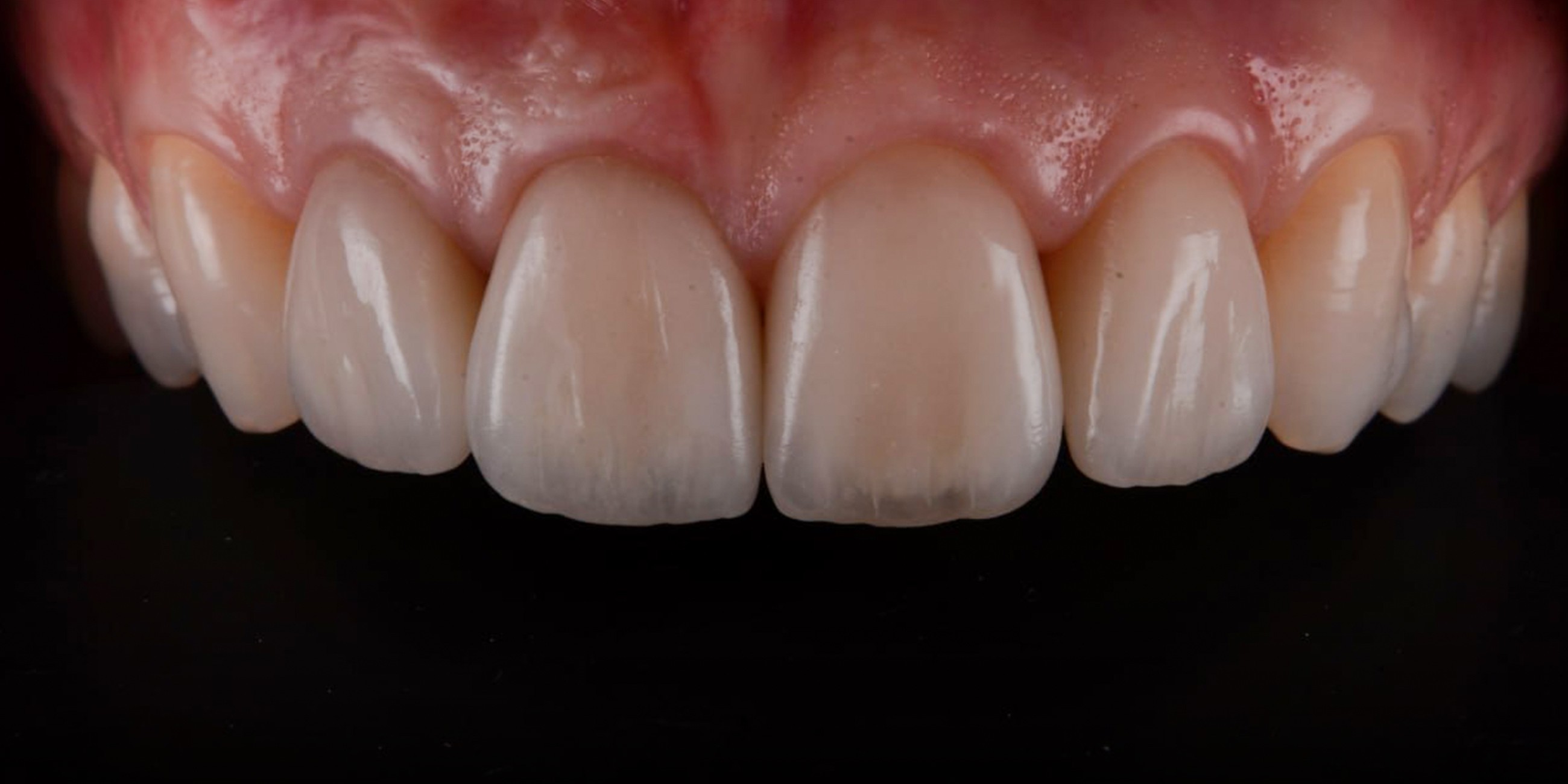 Ceramic Veneers: Interdisciplinary Approach and Updated Protocols