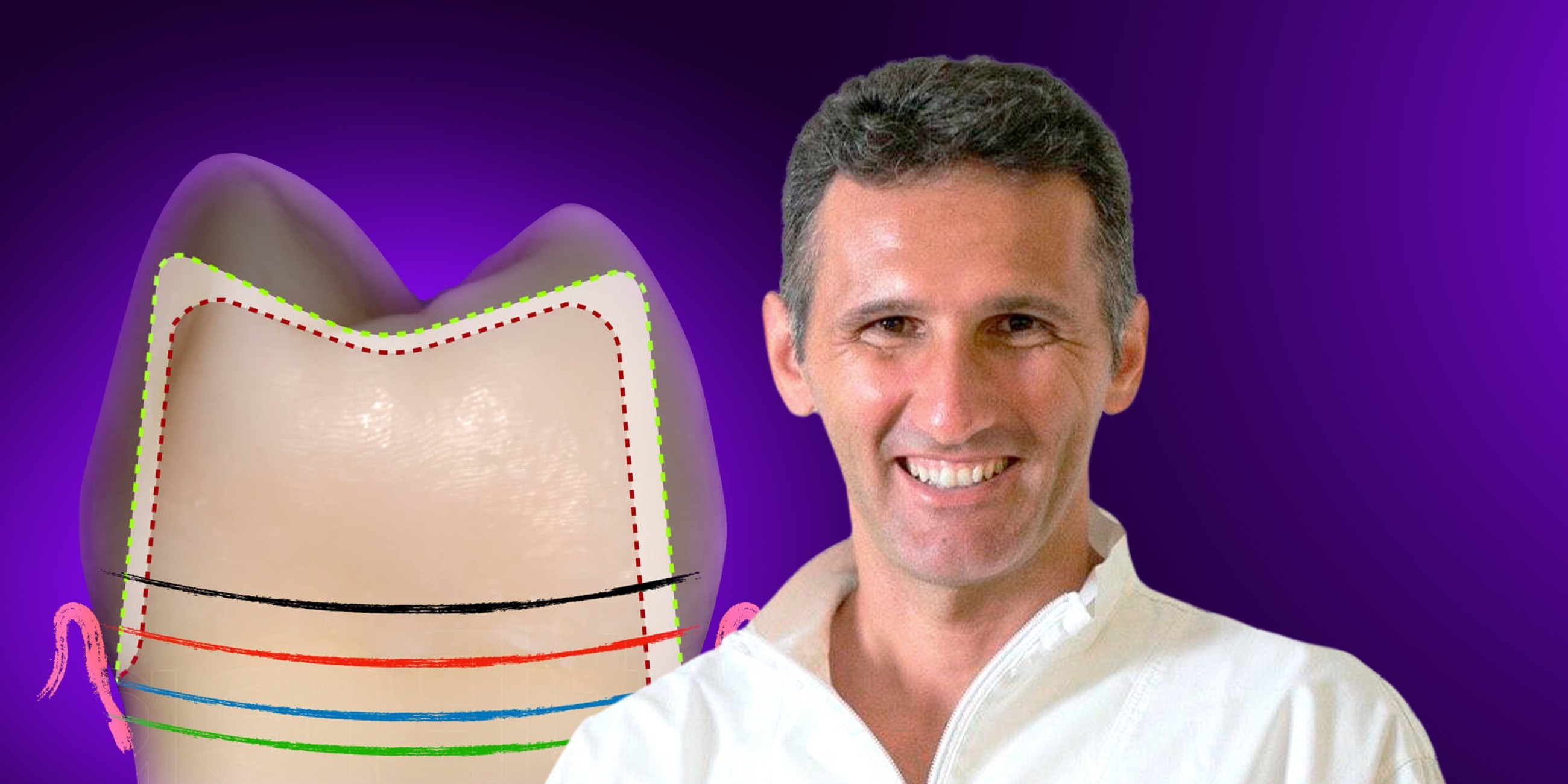 Analog and digital laboratory protocols of zirconia crown restorations ...