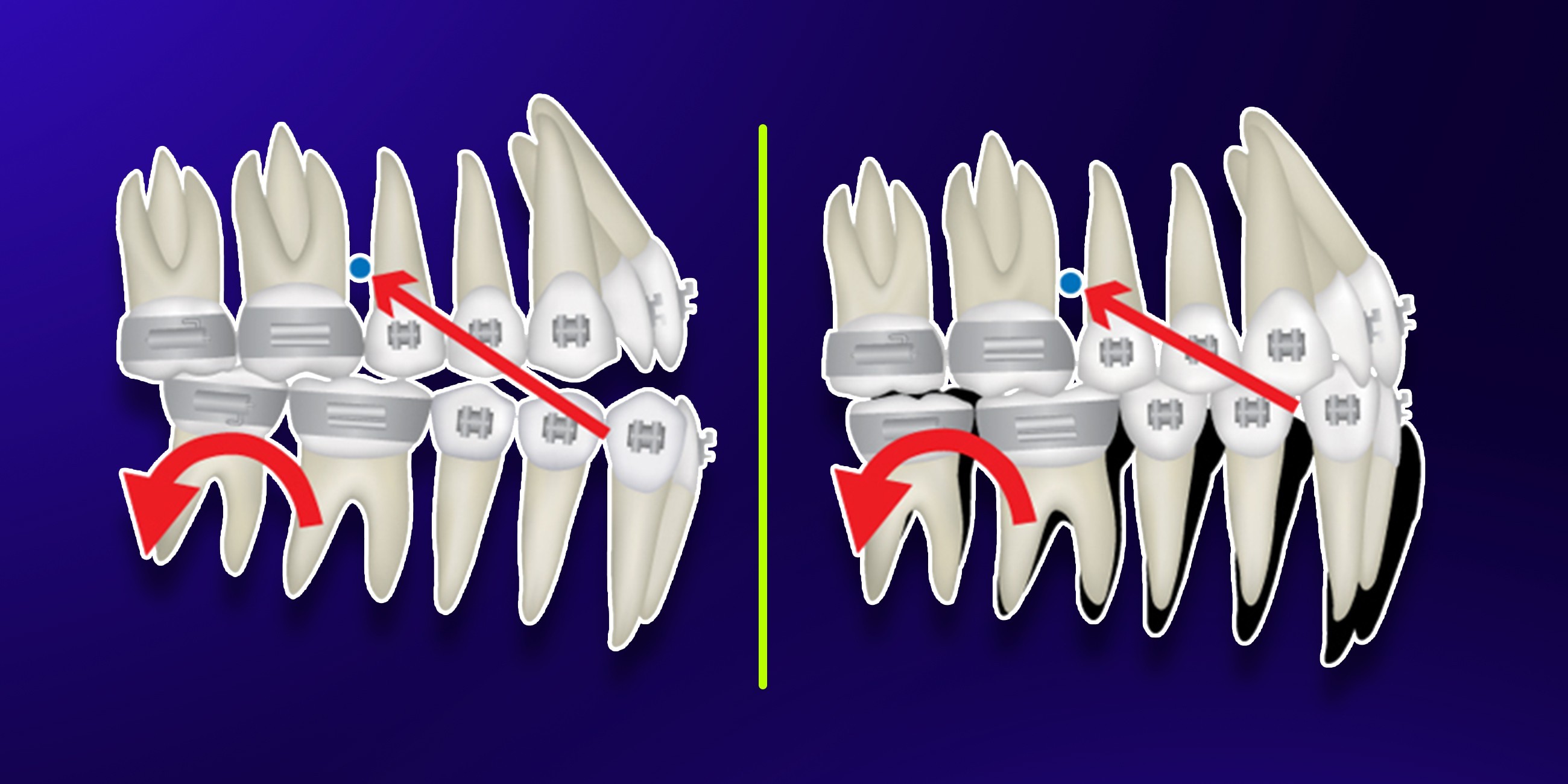 Treatment Protocols of Ectopic Canines and Application of Third Order Bends
