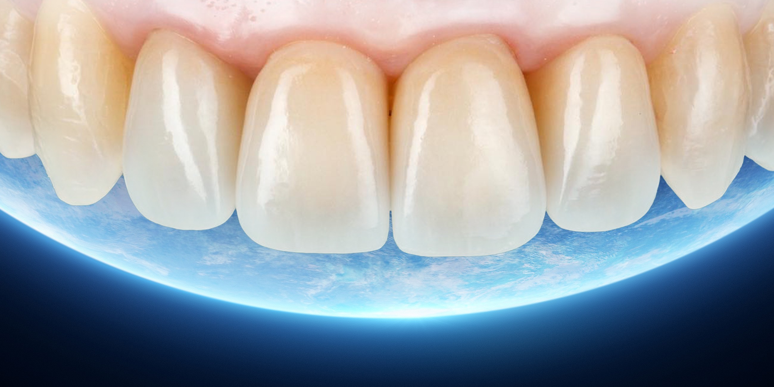 Online lesson on temporary crowns in the VertiPrep concept