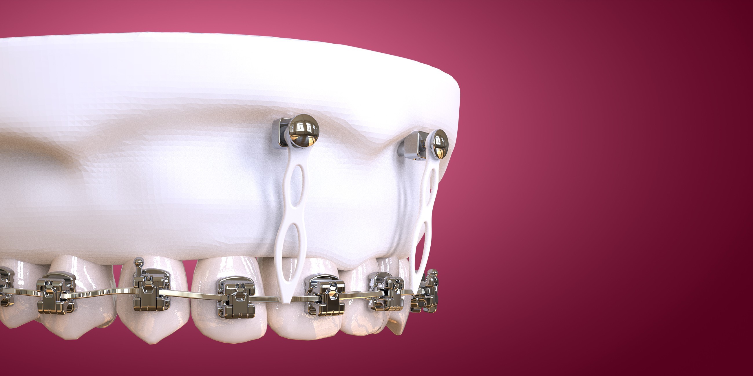 Microimplant Anchorage for Beginners and Intermediate Practitioners