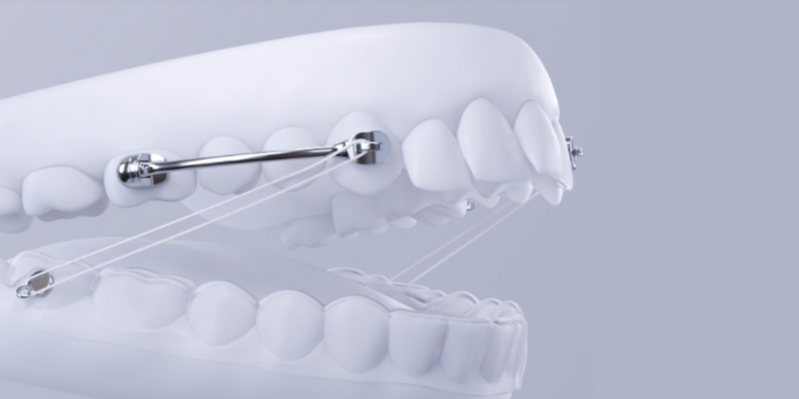 Treatment Protocol of Class 3 with Carriere Motion appliance