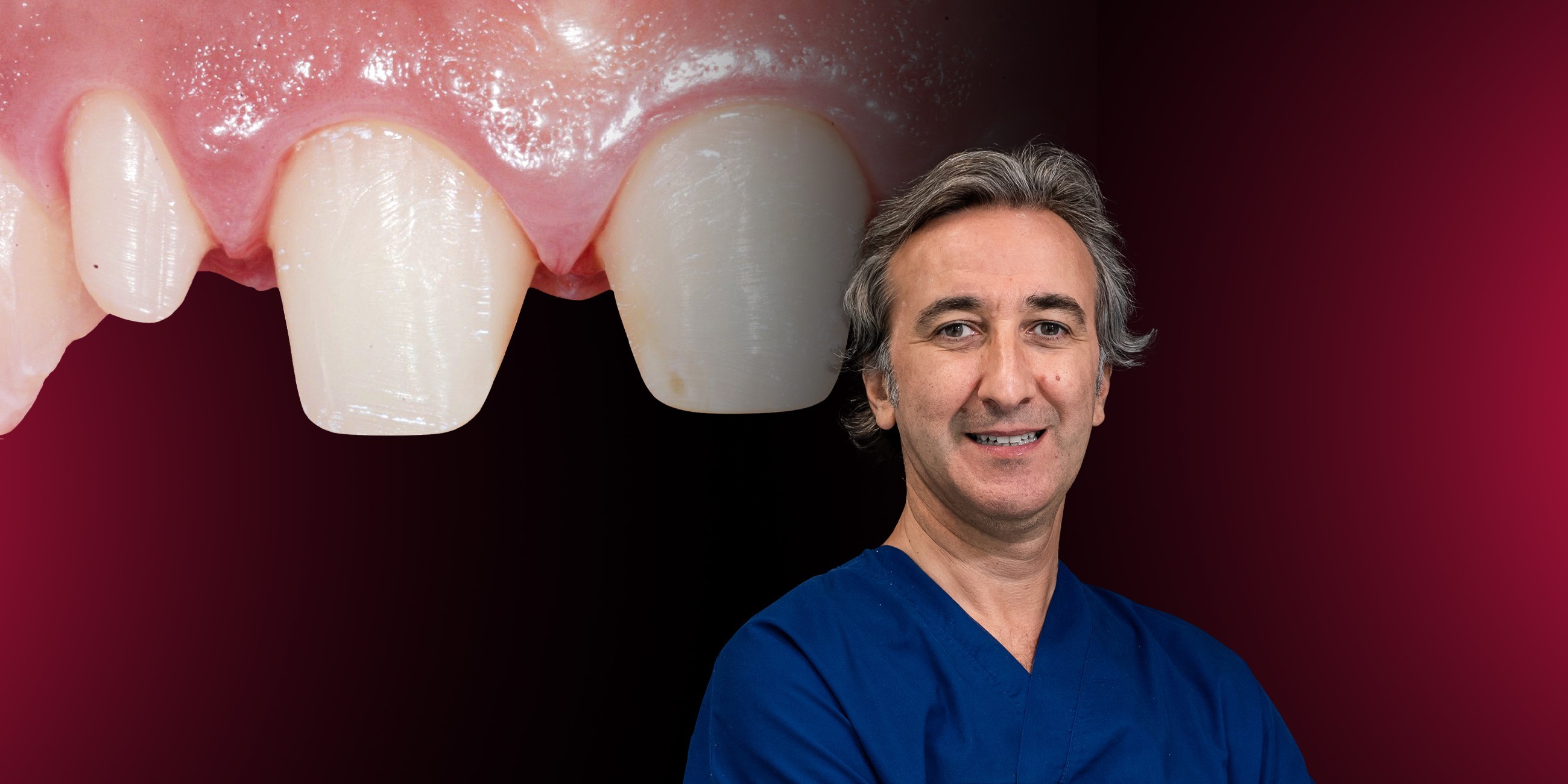 Vertical Preparation and Simplified Prosthetics Protocol (SPP ...