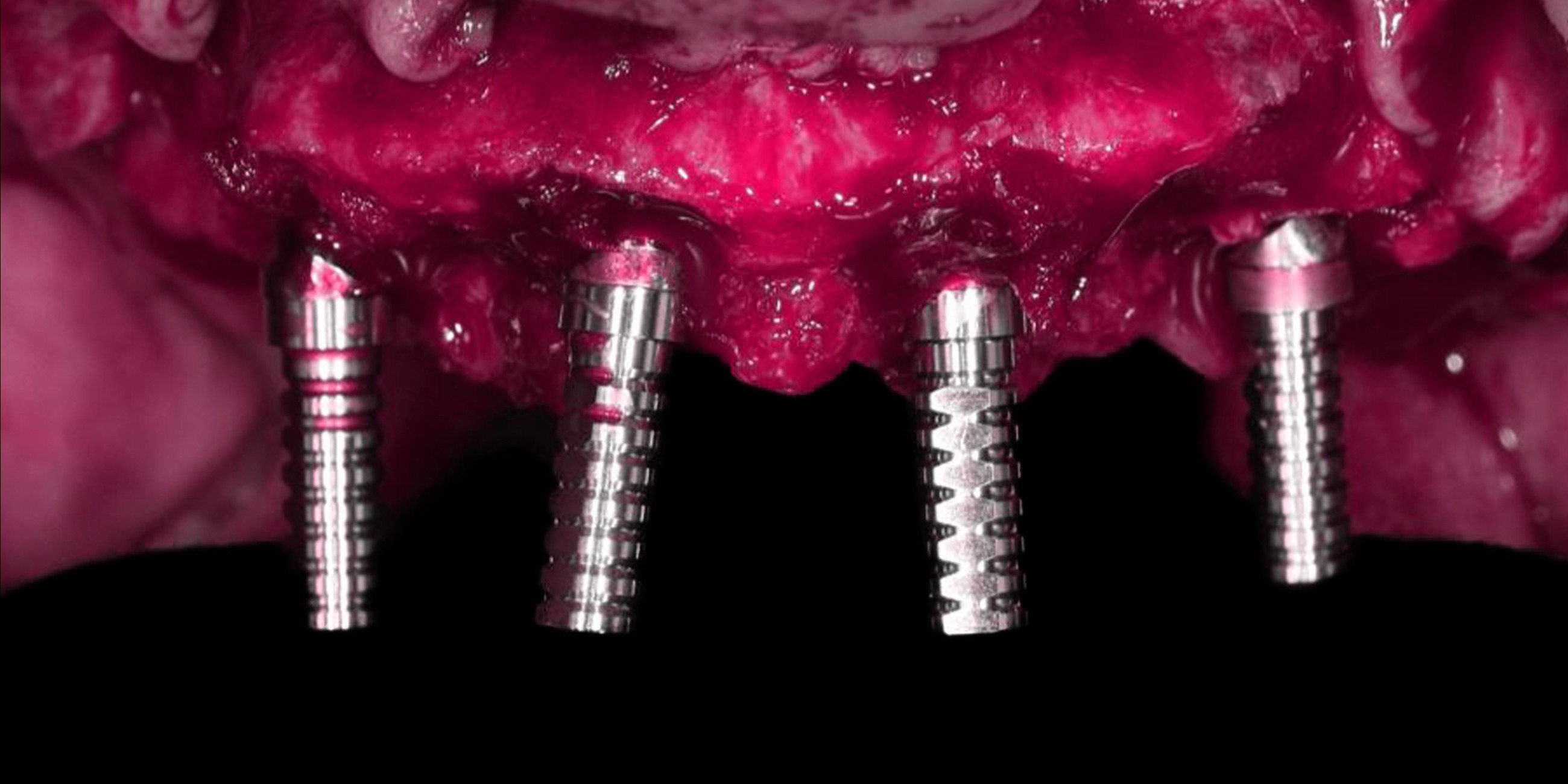 Zygomatic, pterygoid, trans-sinus, tilted implants, and long ...