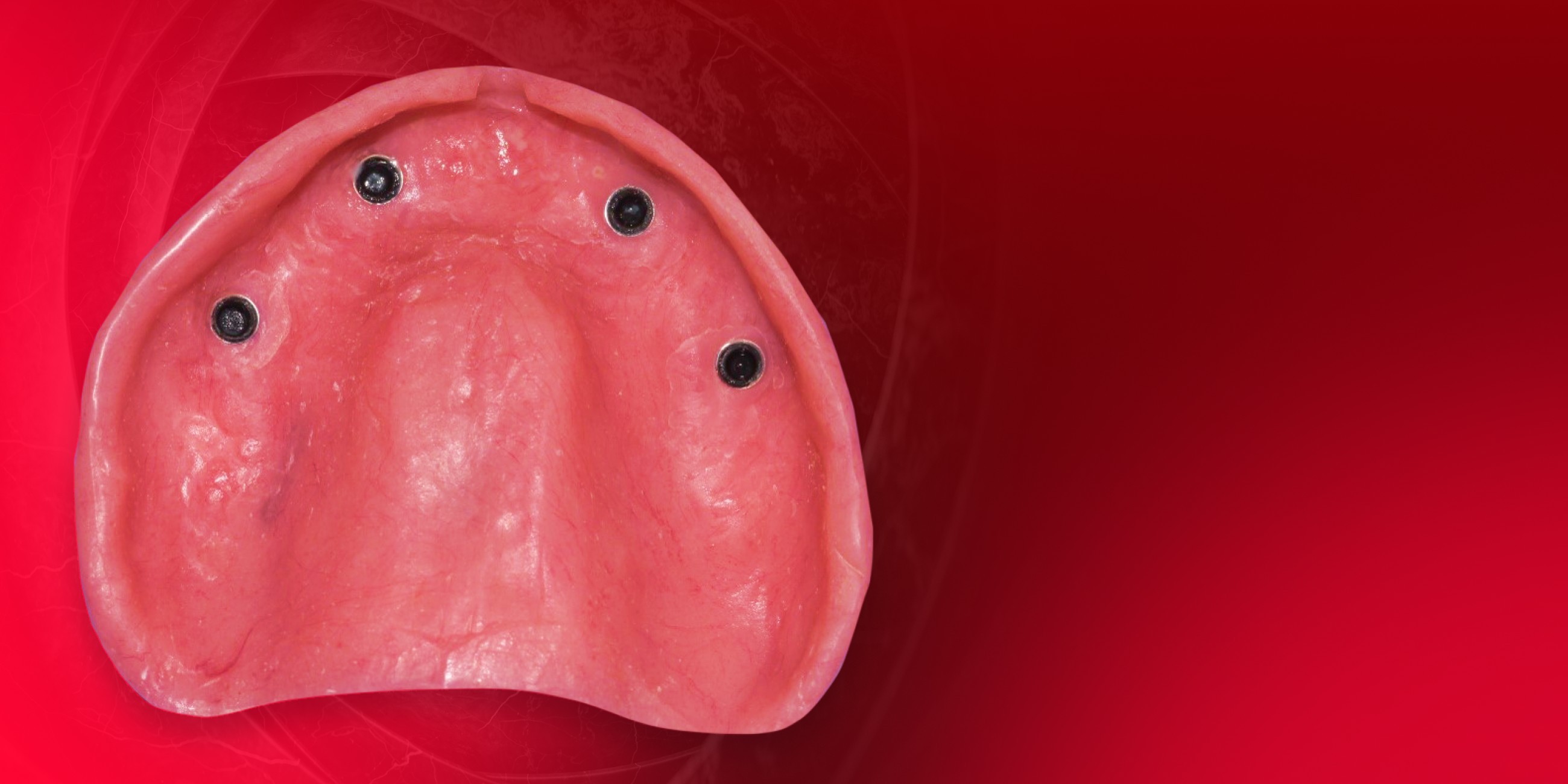 Digital and Friction Fit Dentures: Fixed Function in a Removable Option