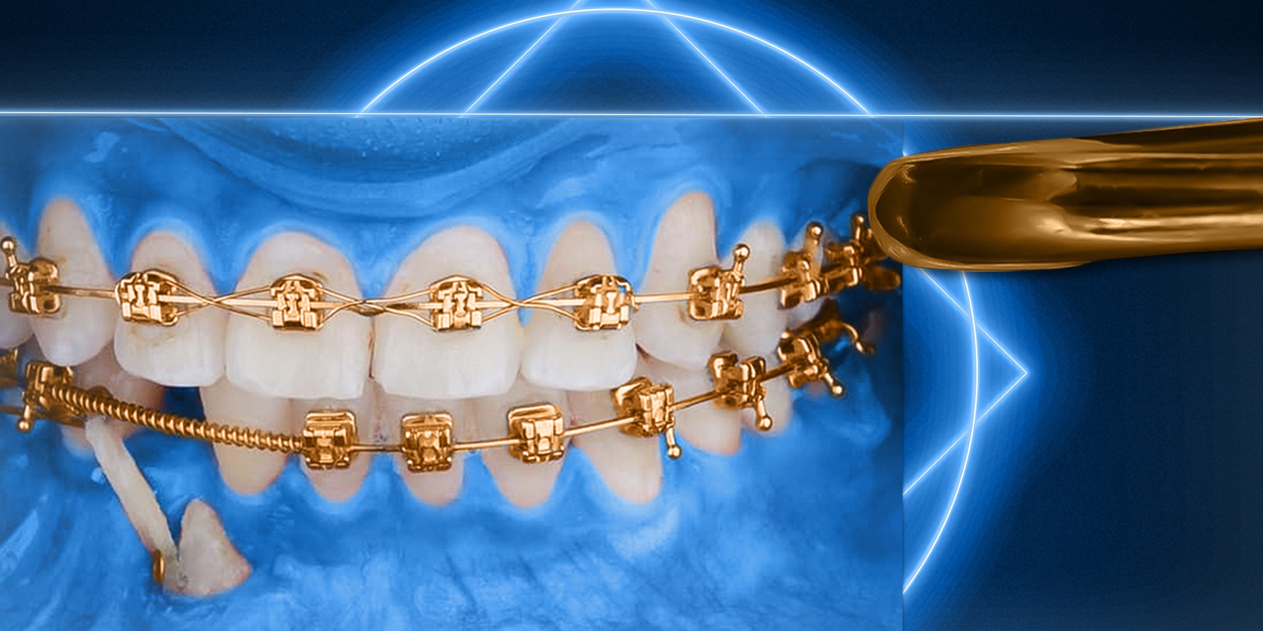 Impaction treatment. Author’s protocols, mistakes and solutions