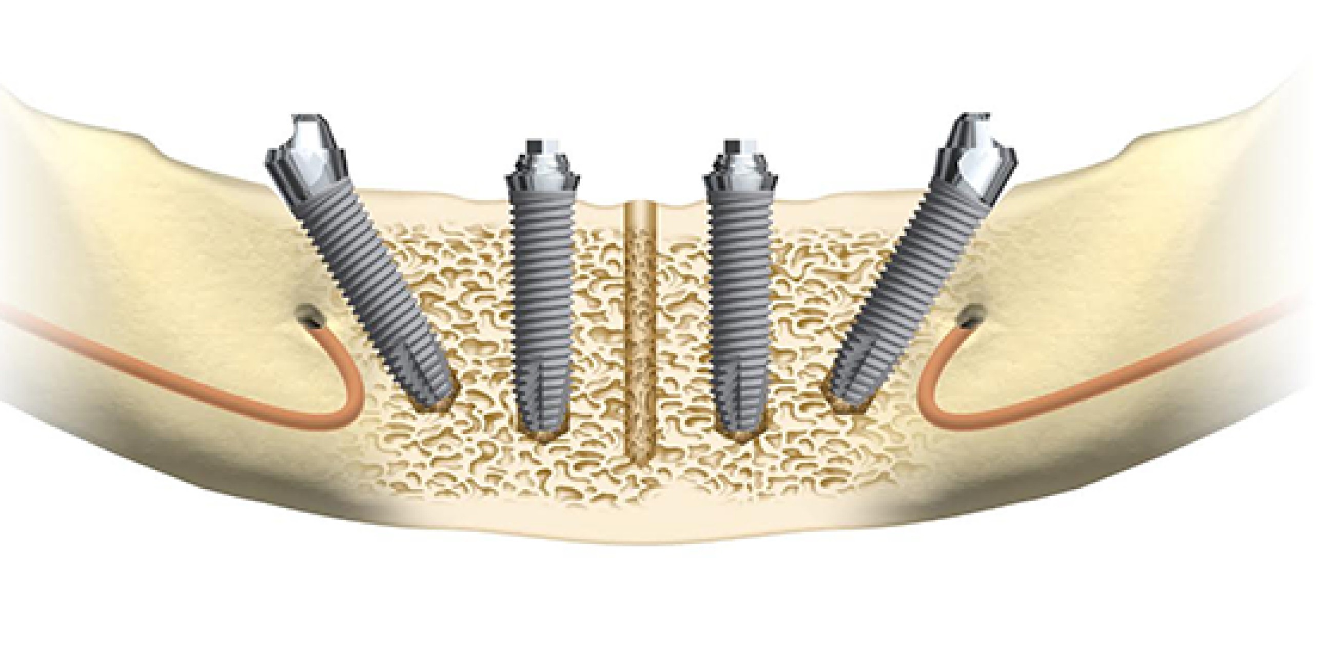 Maintenance of Immediate Function Restorations: The First Phase Maintenance