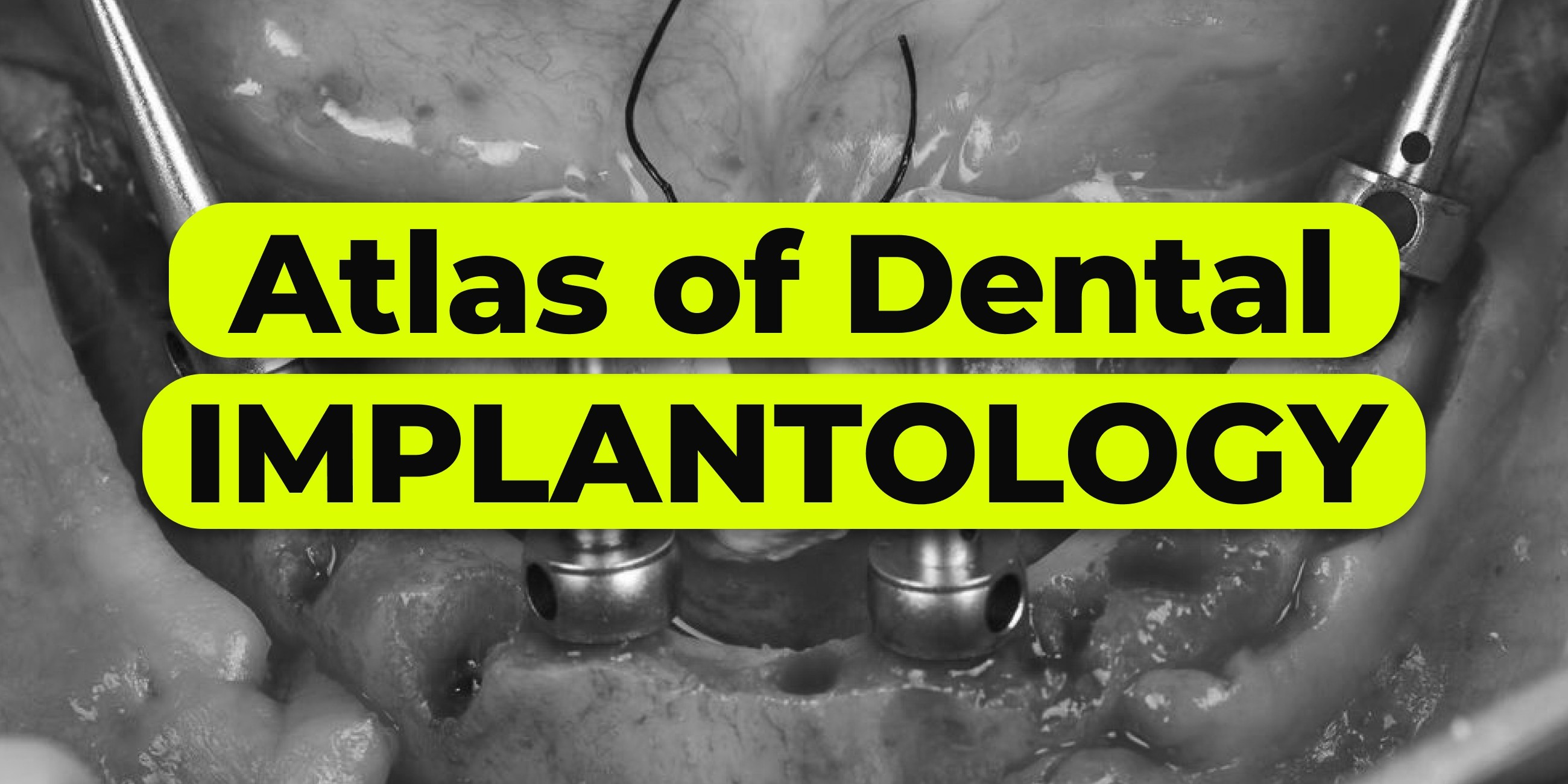 Implant Complications in Aesthetic Zone and Protocols for Their Management
