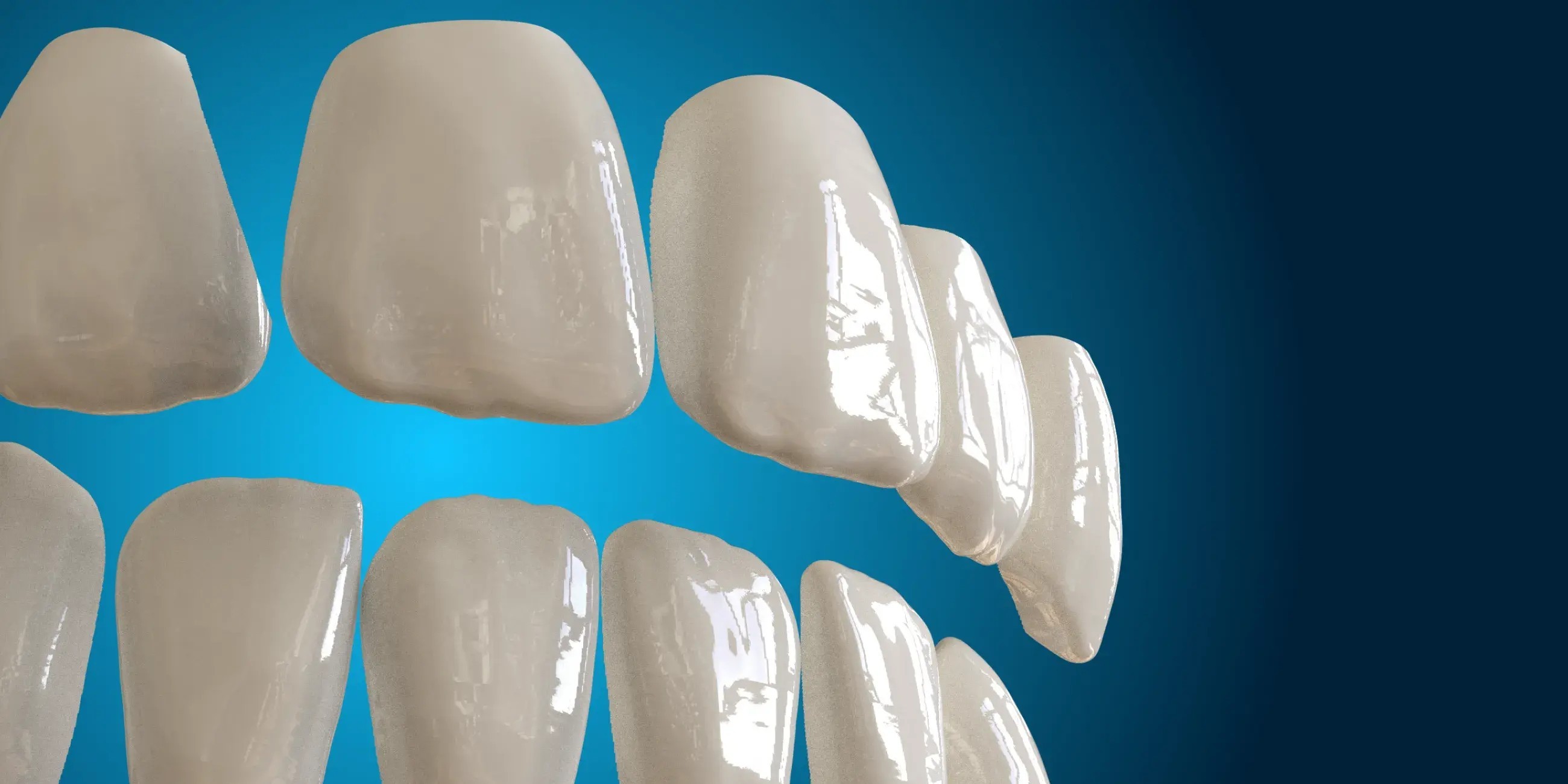 Shell Temporary Crowns with Basil Mizrahi - Relining Acrylic Eggshell ...