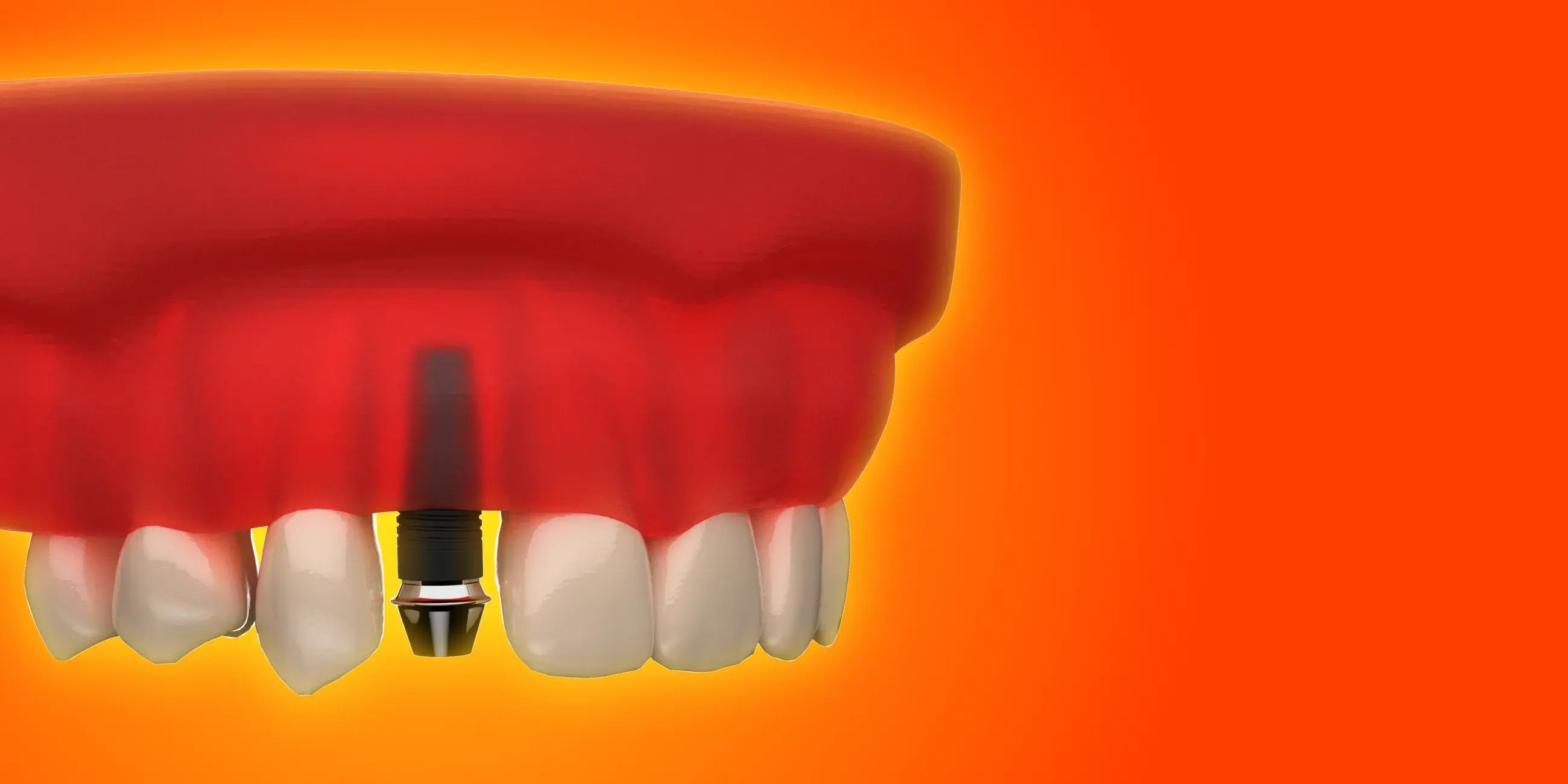 Dry Sockets - How to Prevent and Manage Them? Oral Surgery Complications