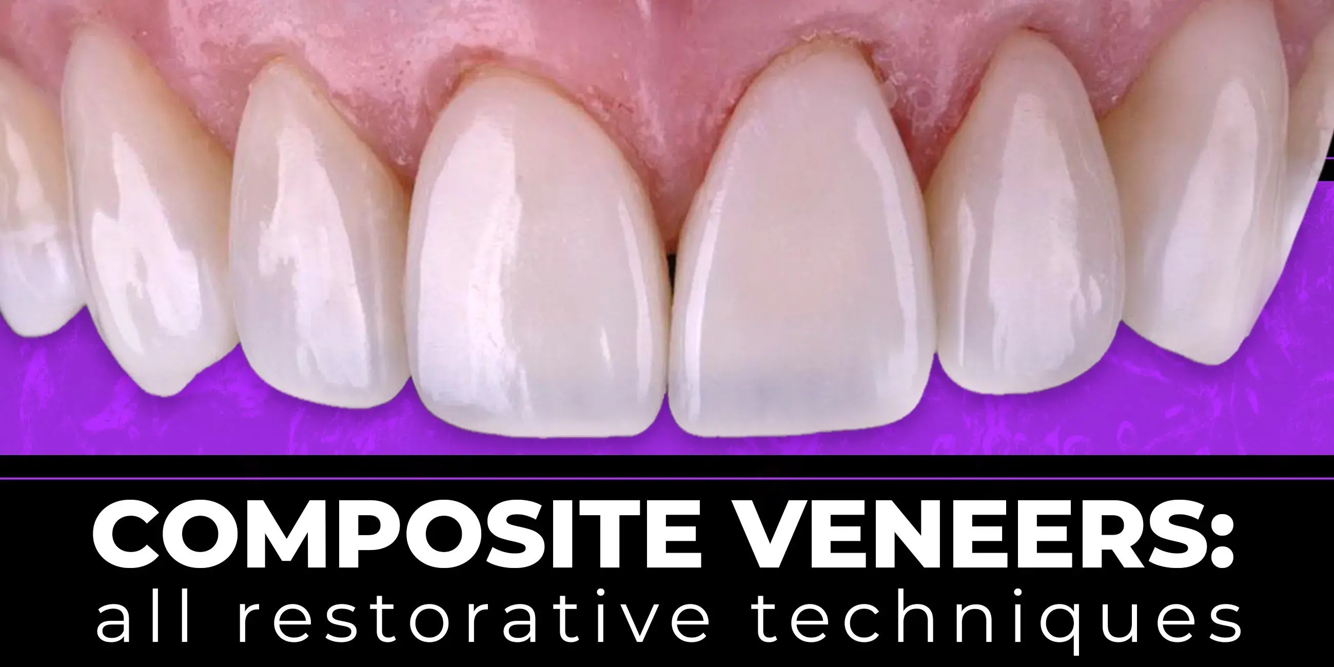 Webinar on anterior composite veneer techniques, diastema
