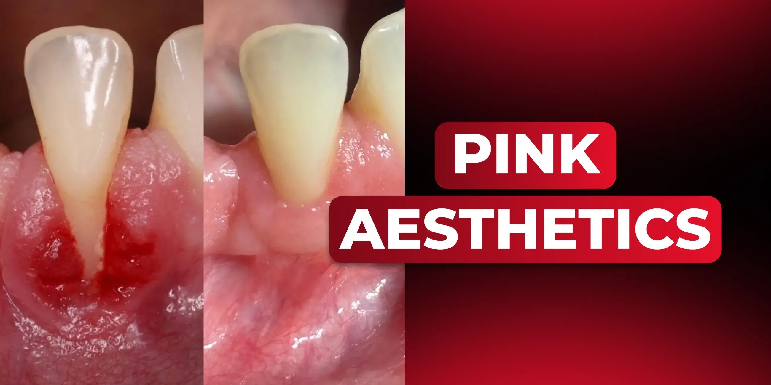 Pink Aesthetics: Recession and Gingival Smile Treatment
