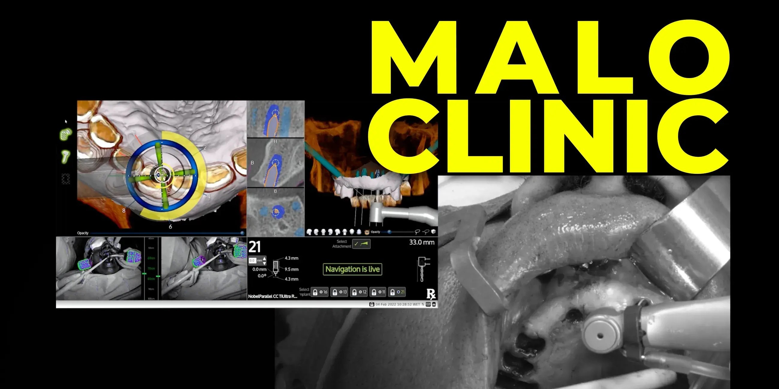MALO CLINIC Navigated Full-Mouth Implant Rehabilitation