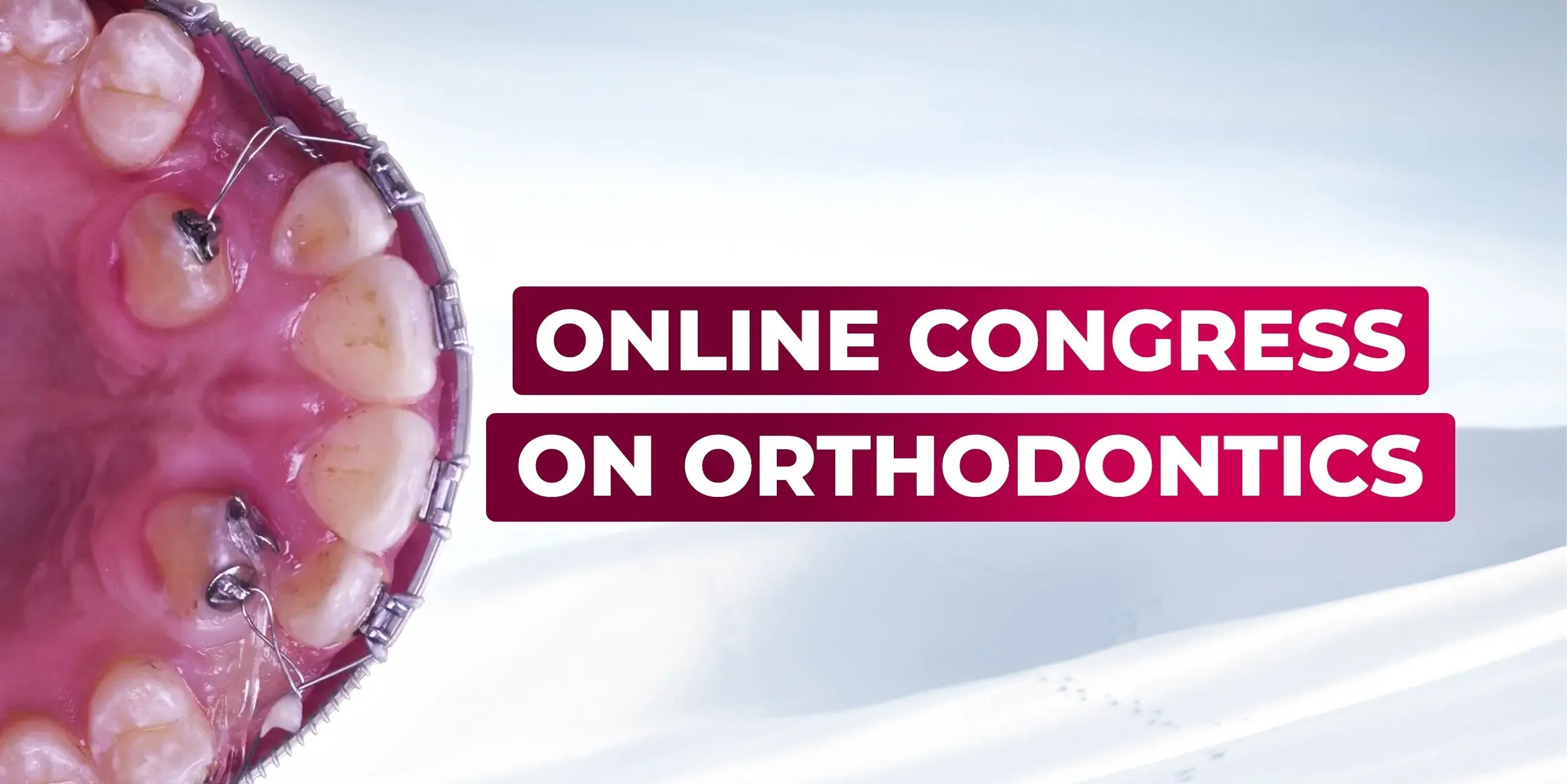 Total arch intrusion in hyperdivergent Class 2 face: a replacement ...