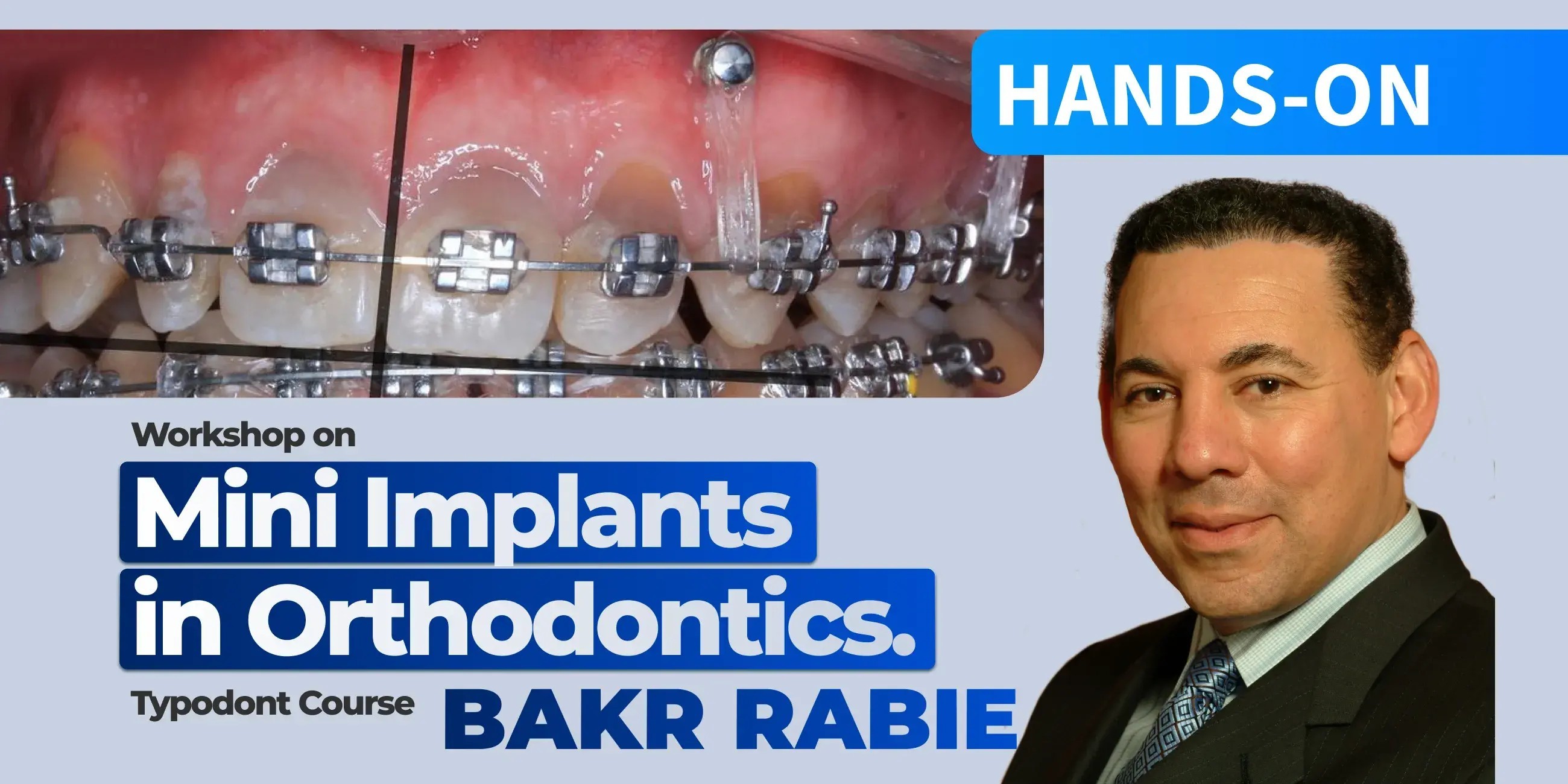 Mini Implants in Orthodontics: Typodont Course with Dr Bakr Rabie