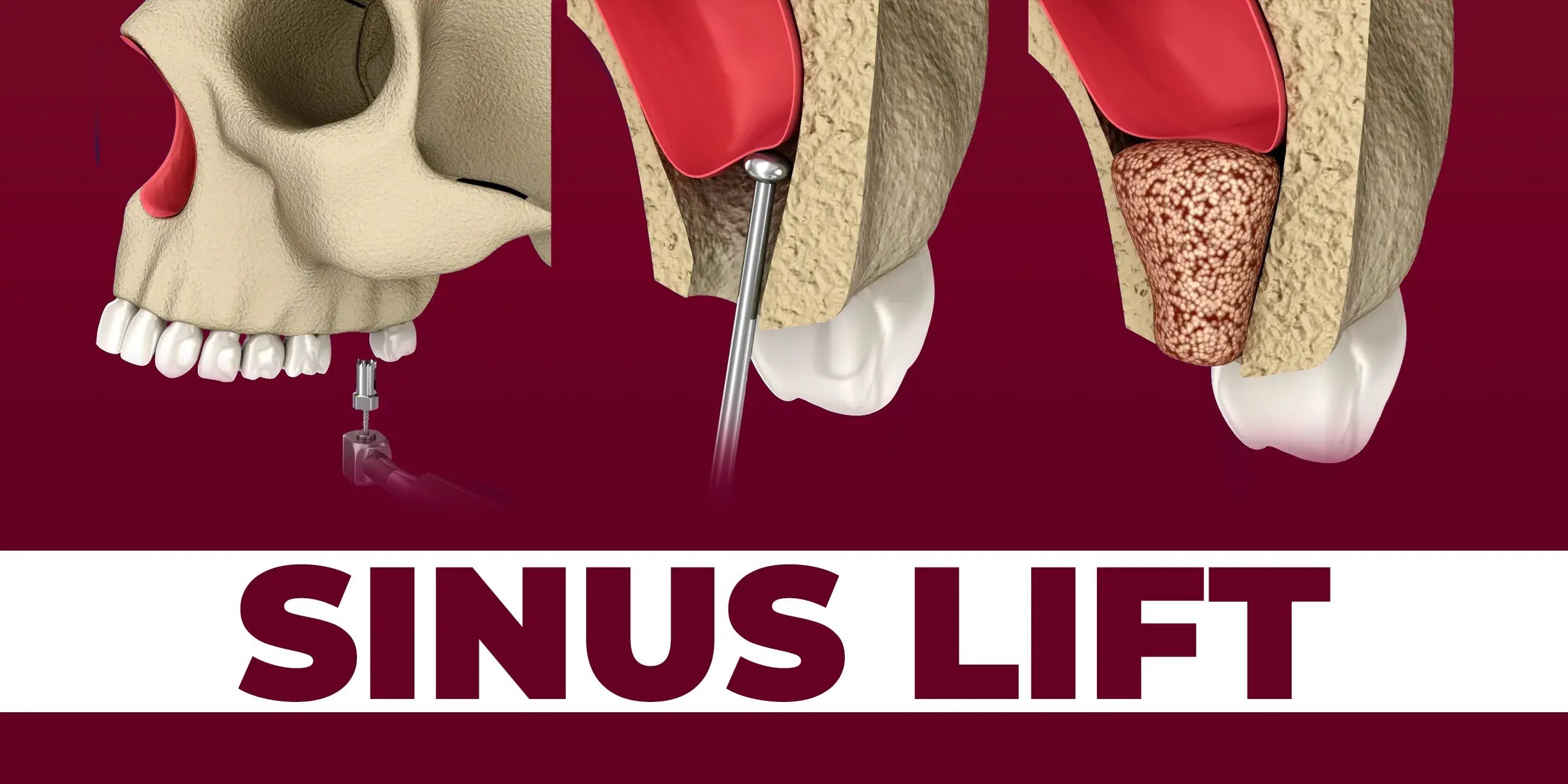 Webinar on principles of flap formation and design, CBCT