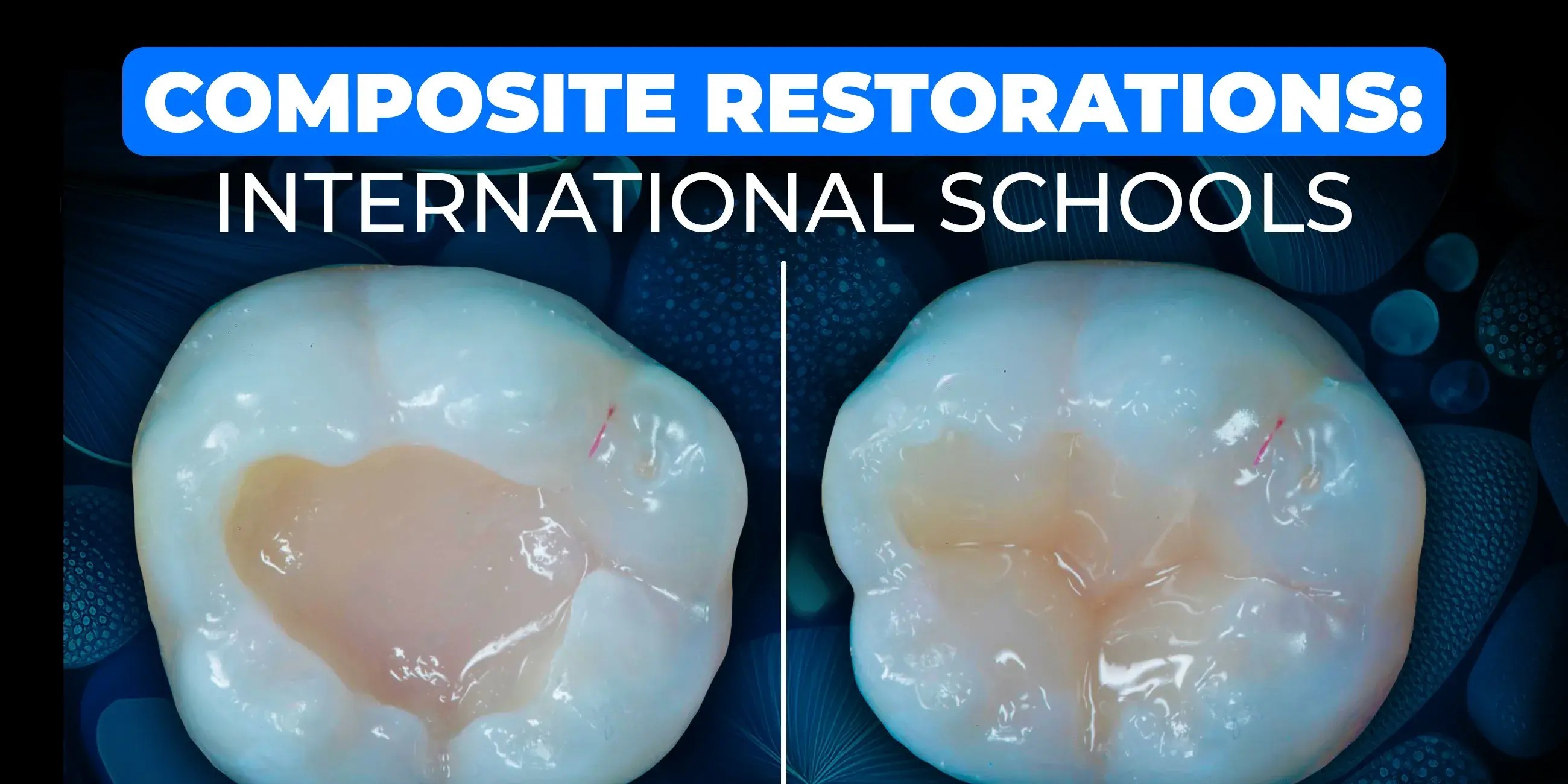 Direct composite posterior restorations with stress reduced and fiber ...