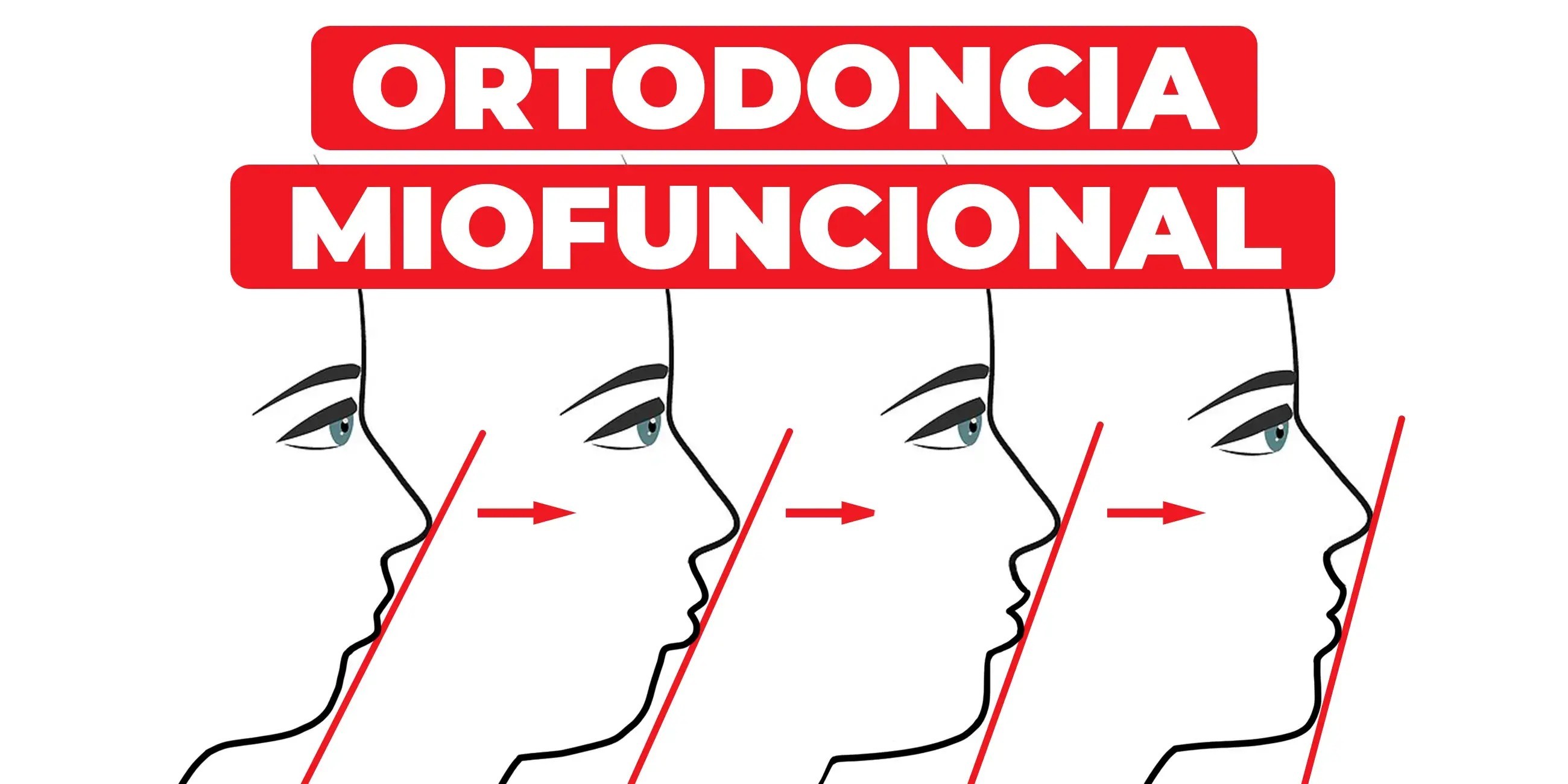 Lengua atada y disfunción oral. El trabajo en equipo detrás del ...