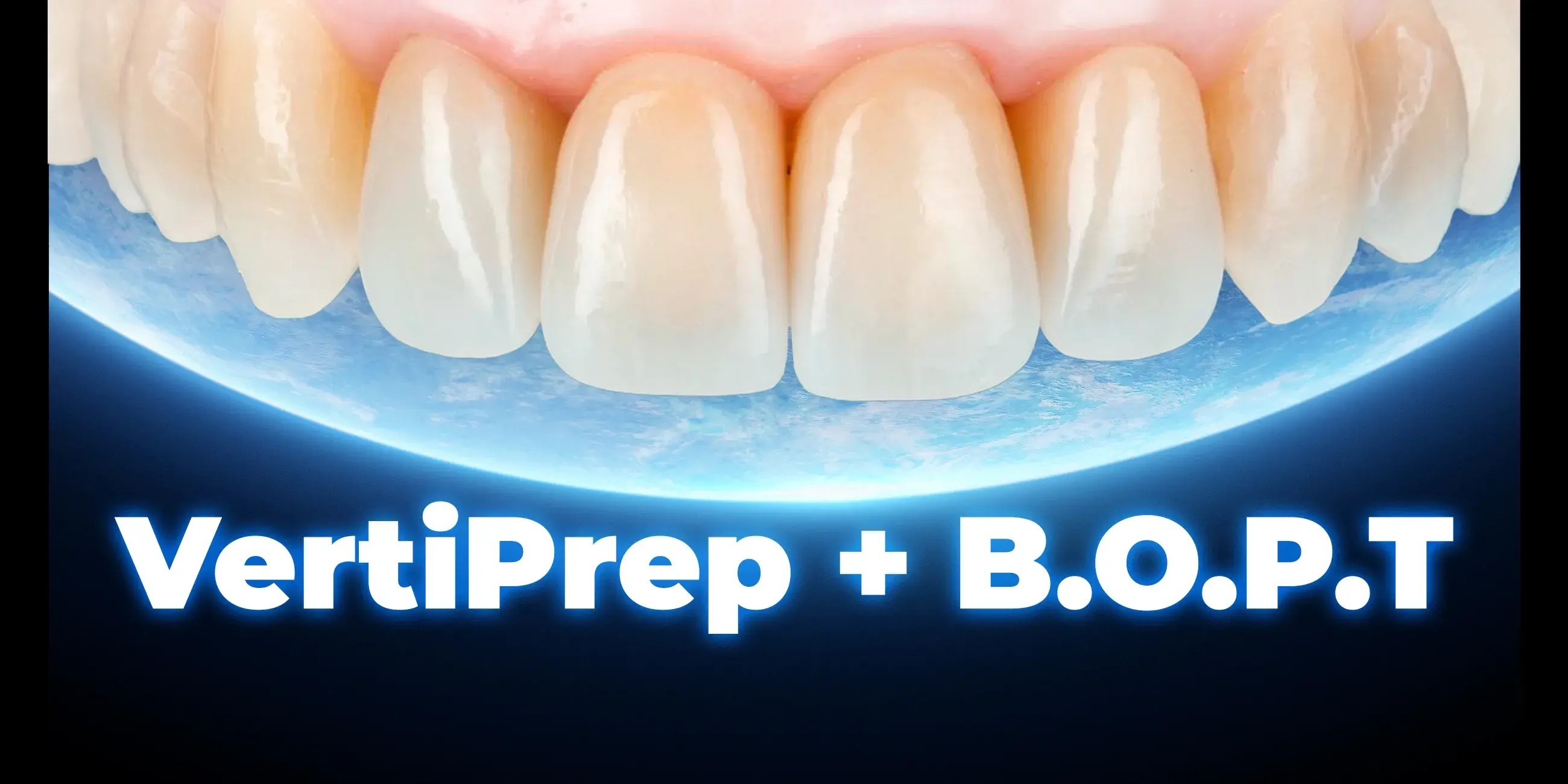 Vertical/shoulderless preparation, guided wax-up dissection: webinar