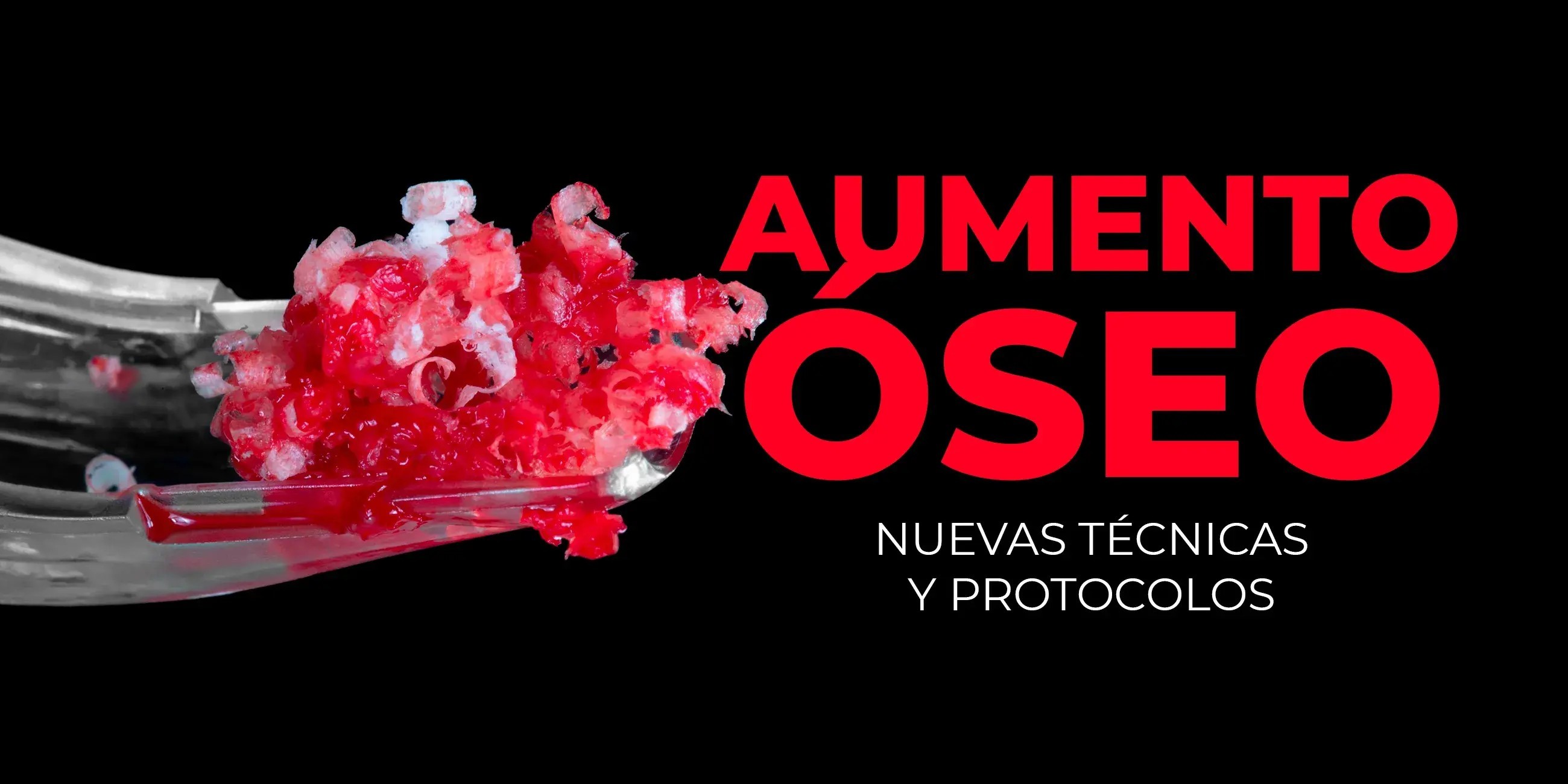 Aumento óseo vertical 3D
