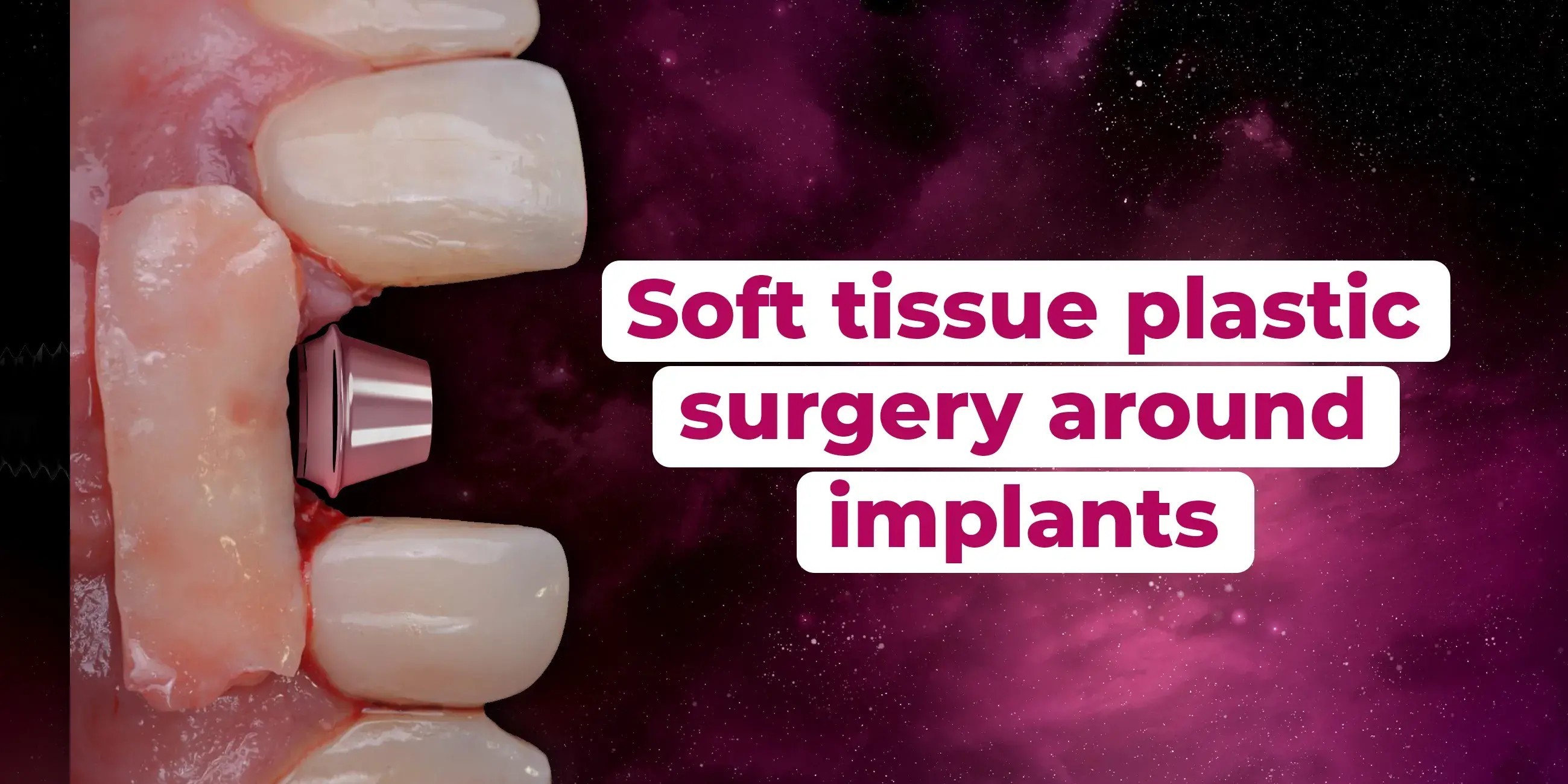 Webinar: soft tissue around implants, non-surgical technique