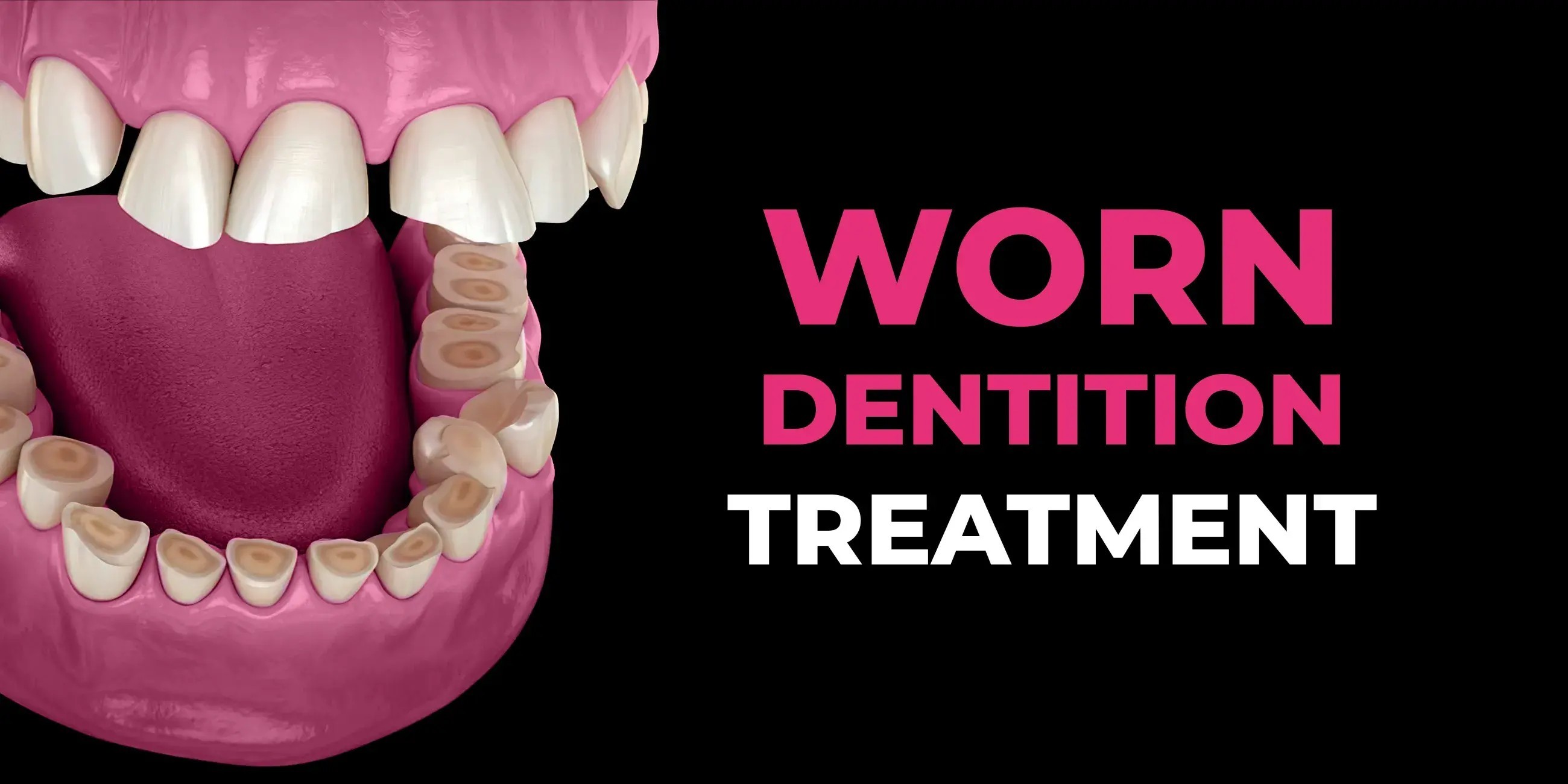 Treatment of tooth wear, occlusive rehabilitation: webinar
