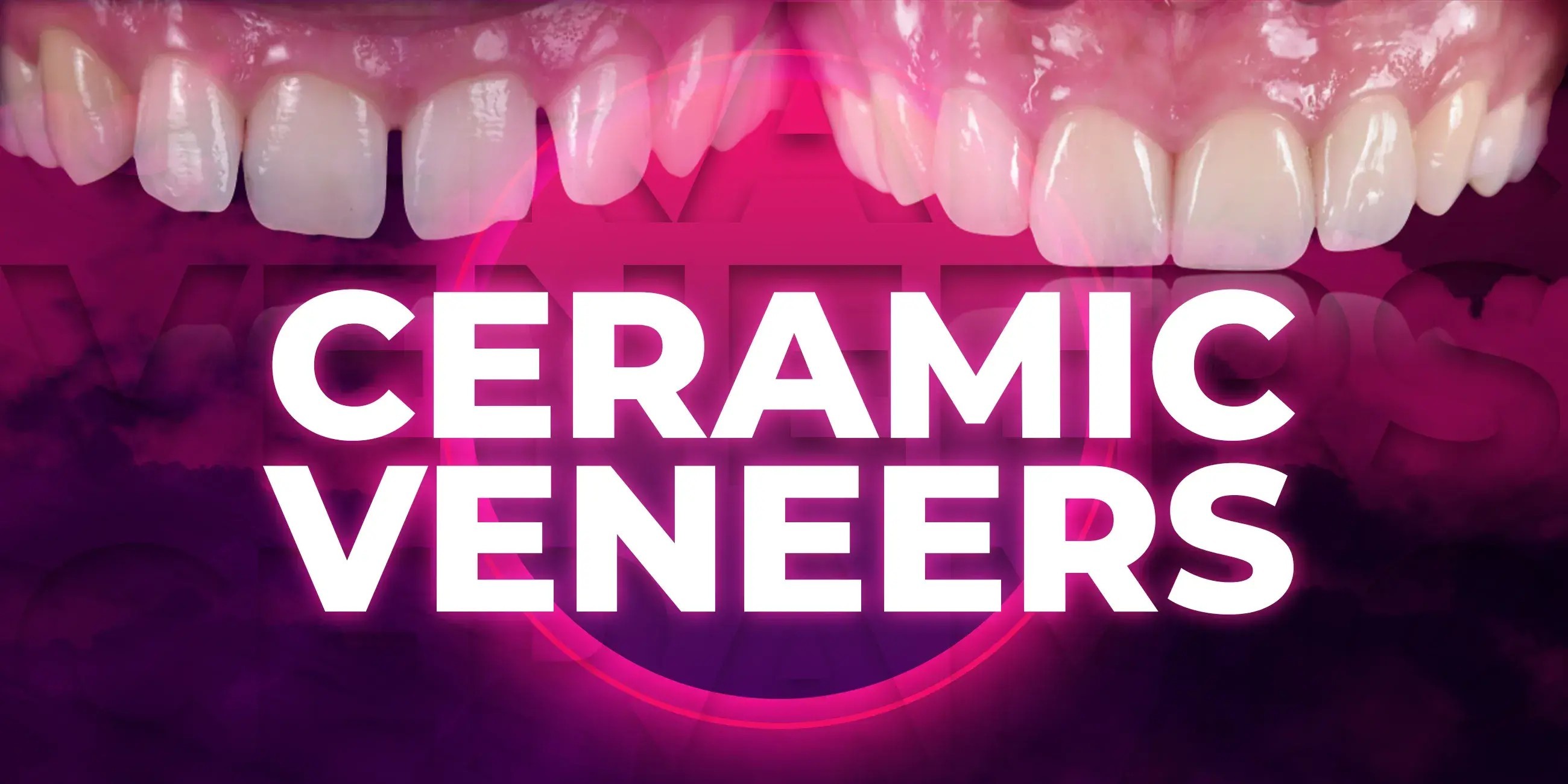 CEREC ceramic veneers: detailed protocol. Introductory lesson