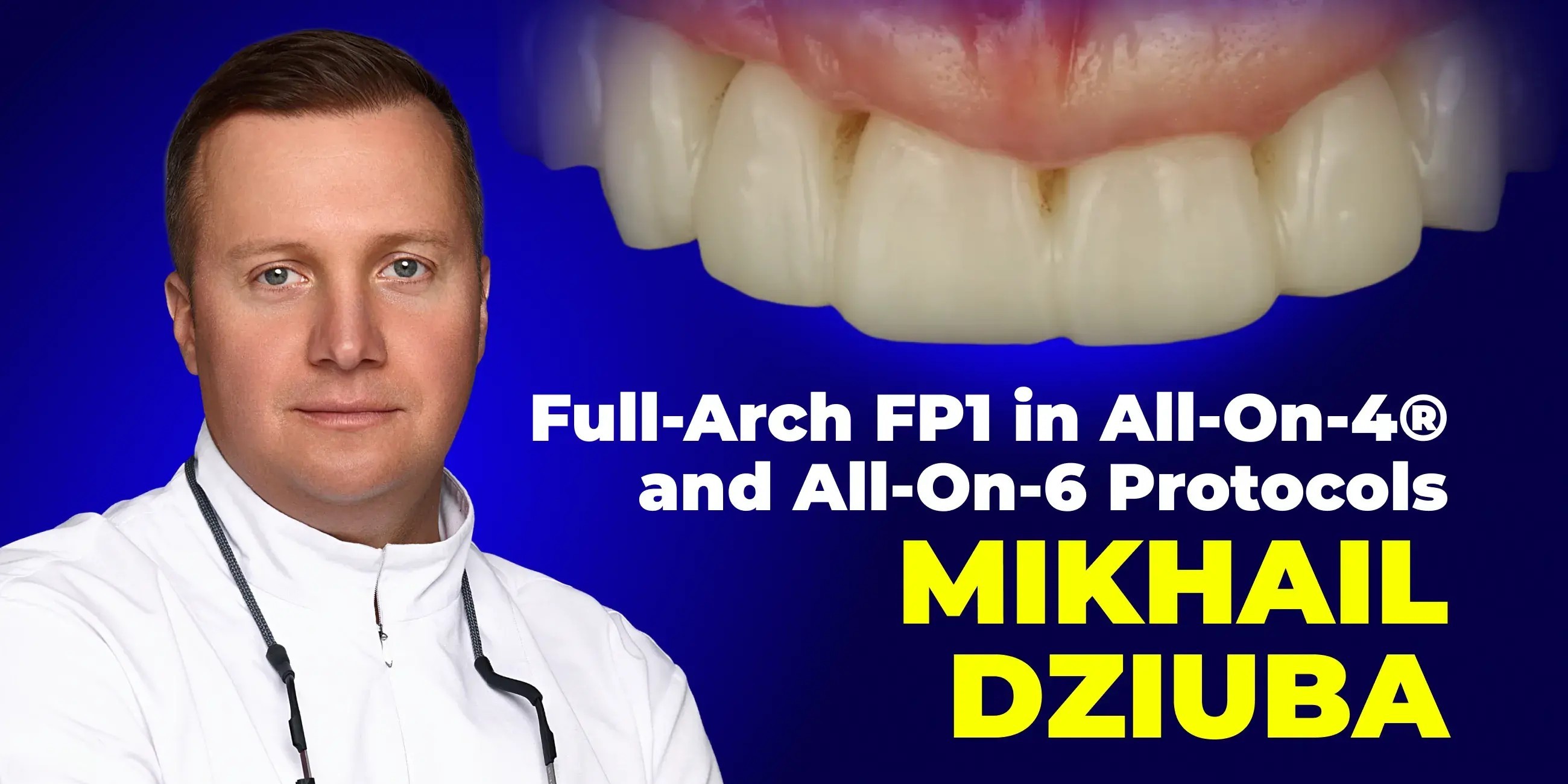 Hybrid Zygoma Implants and All-On-6 FP1 Protocols: Comprehensive Case Studies and Solutions