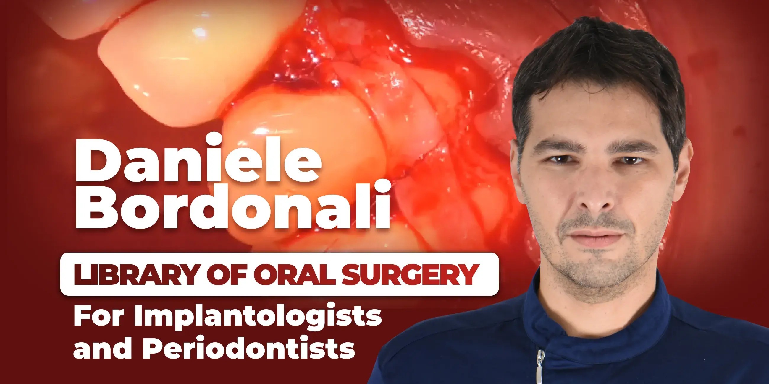 Upper Jaw Guided Bone Regeneration (GBR): Results 6 Months Post-Procedure