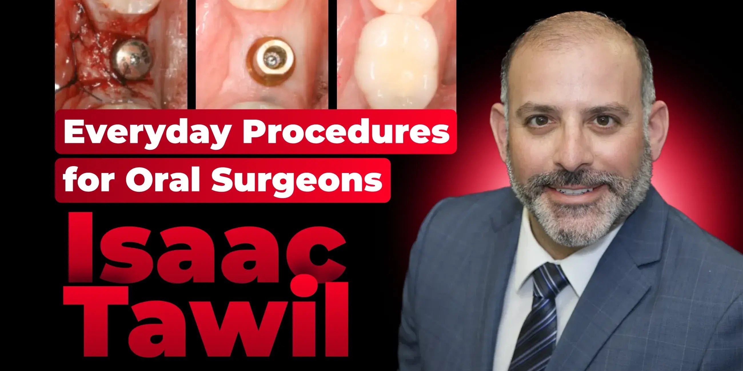 Everyday Procedures for Oral Surgeons: Implantation & Simplified Tooth ...