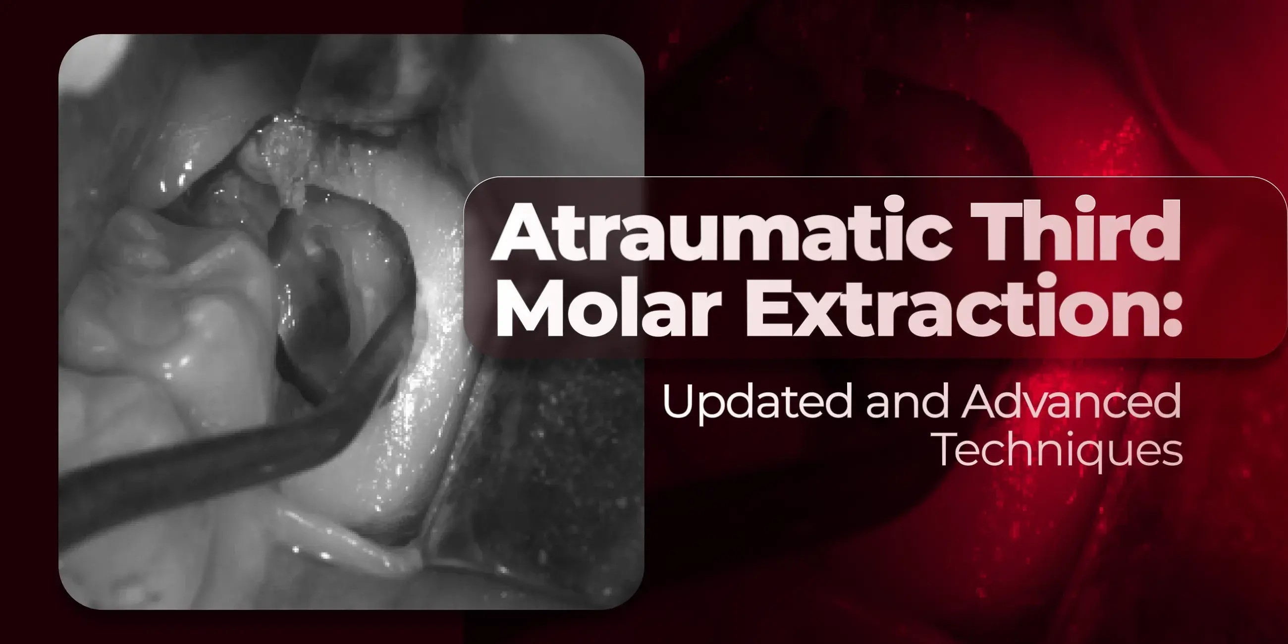 Surgical Extraction of Impacted Lower Third Molars