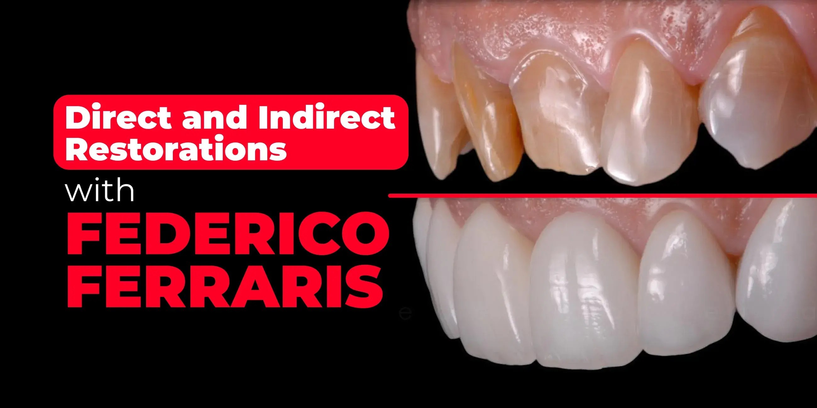 Operative Dentistry: Direct and Indirect Restorations with Federico ...