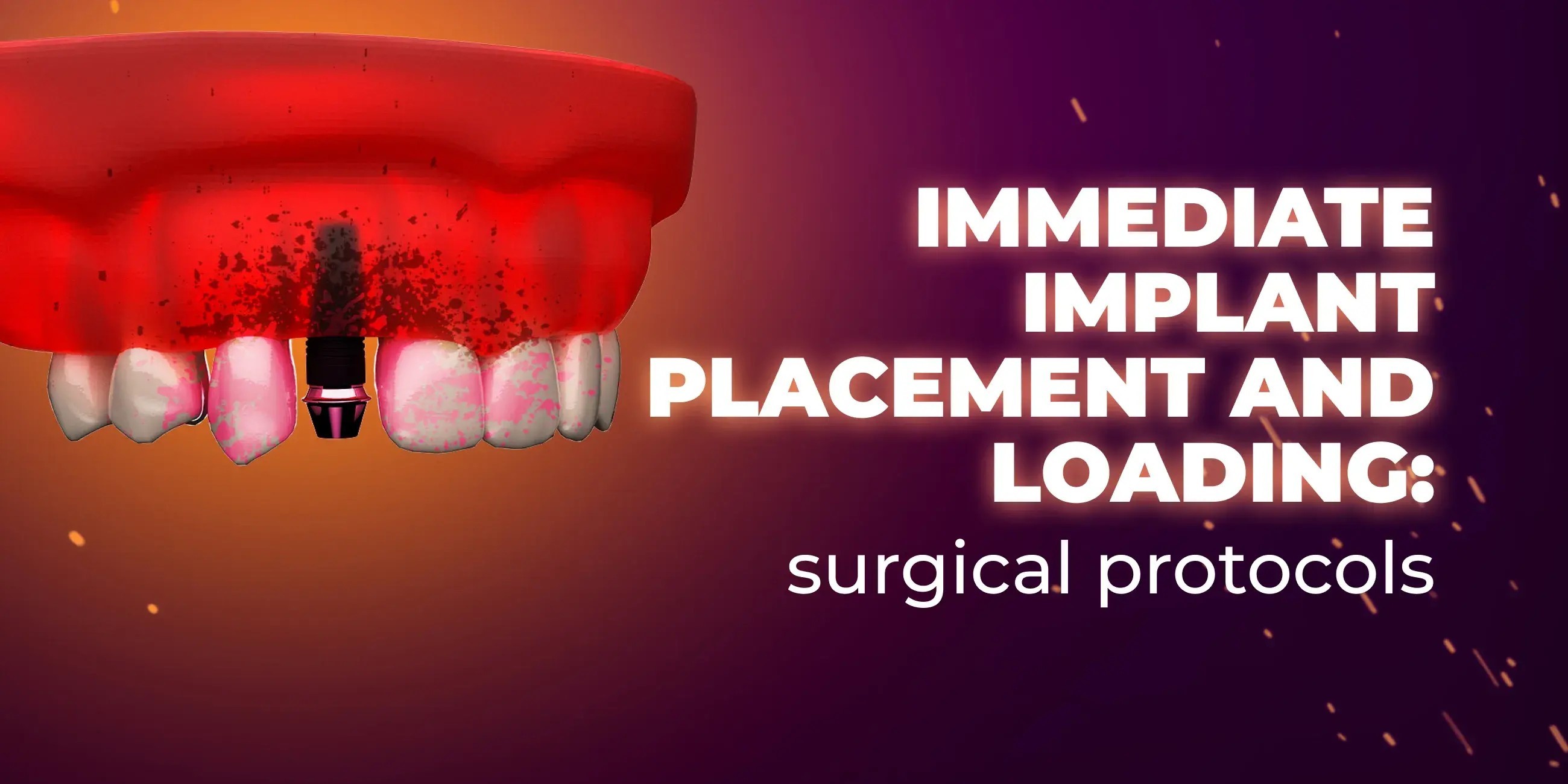 Webinar: immediate implants with immediate loading, healing