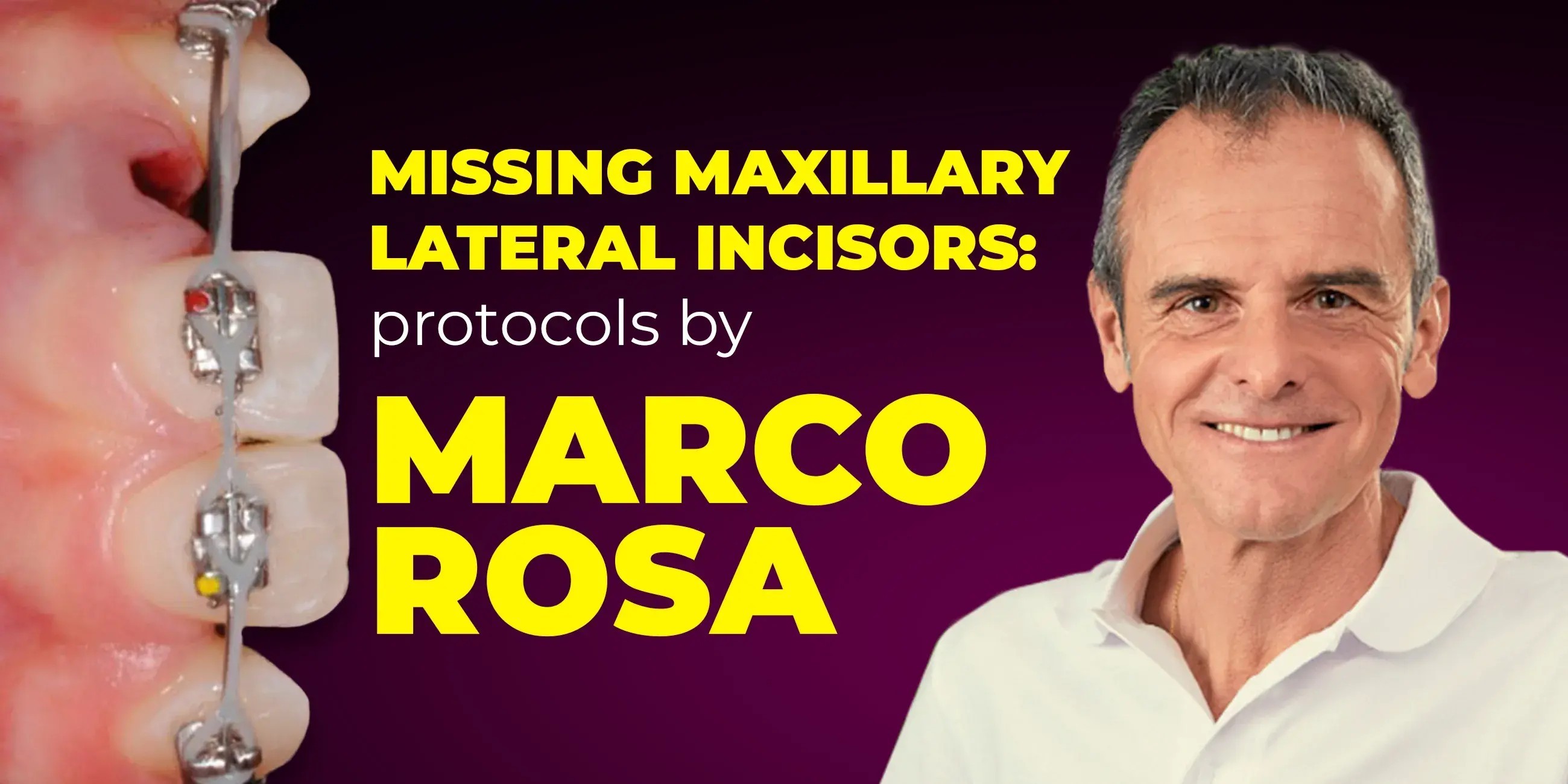 Webinar on sequential tooth extraction and space closure