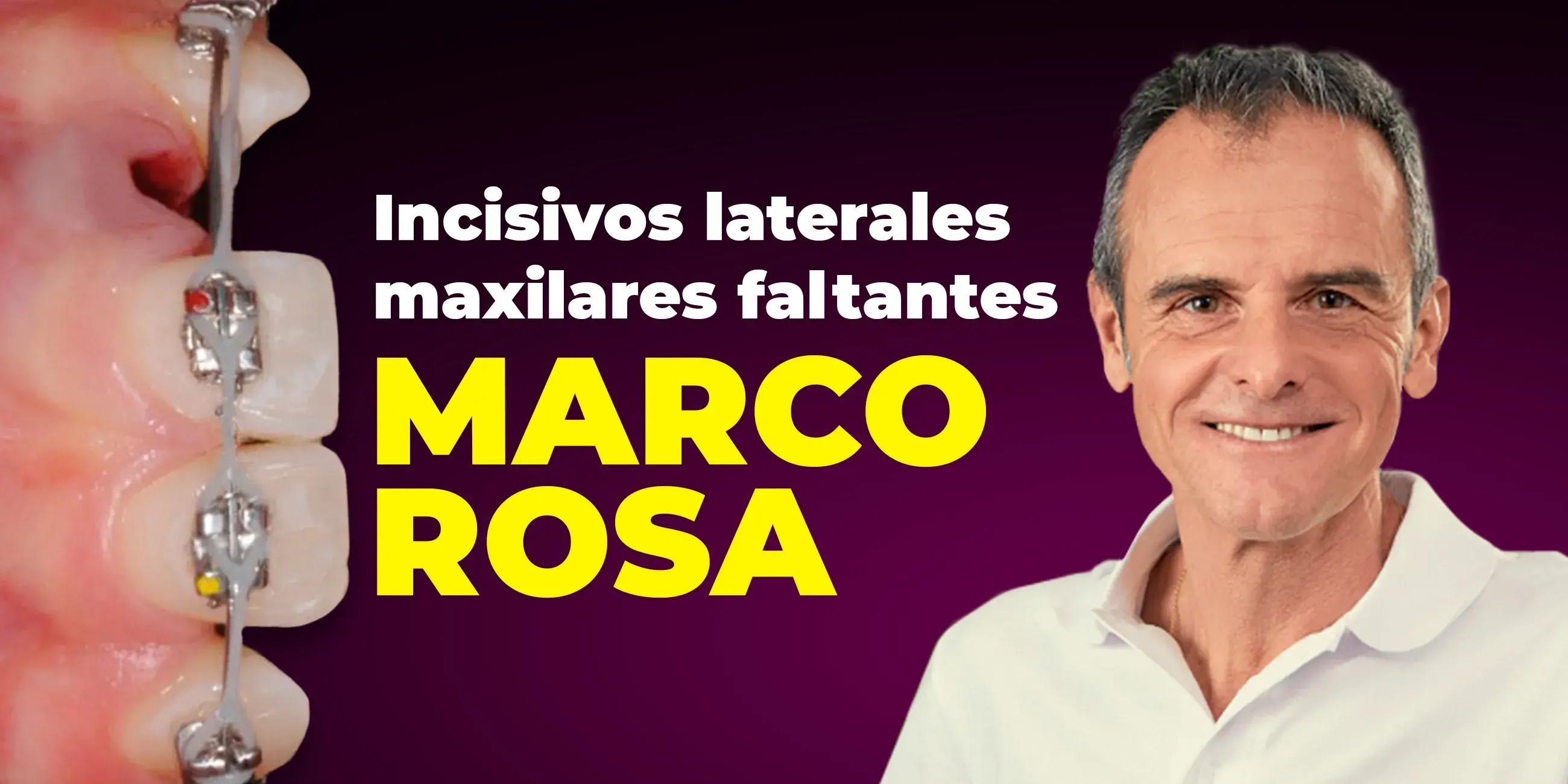 Adentia unilateral de incisivos laterales. Parte 1