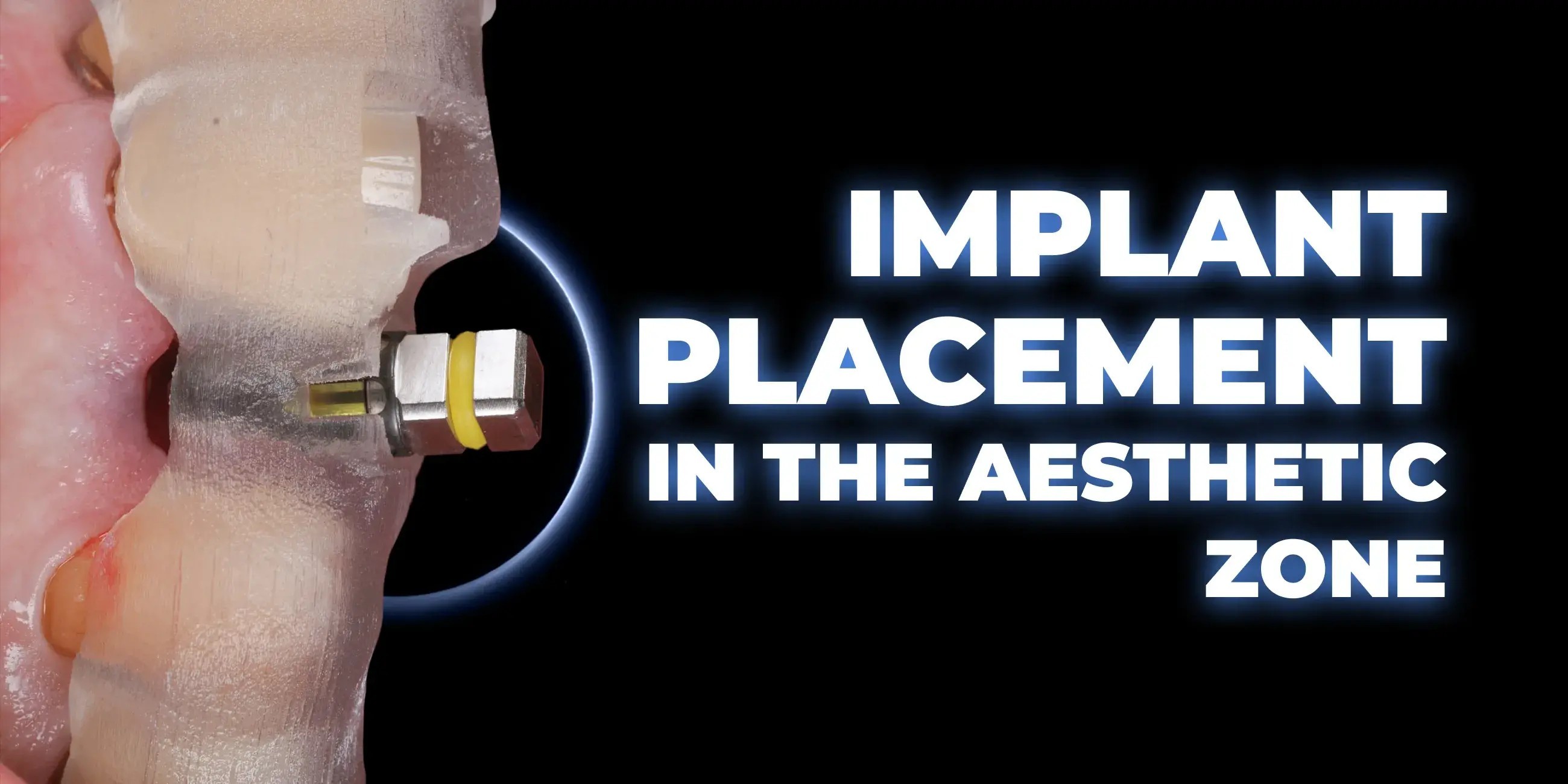 Implantation and prosthetics in the aesthetic zone, webinar