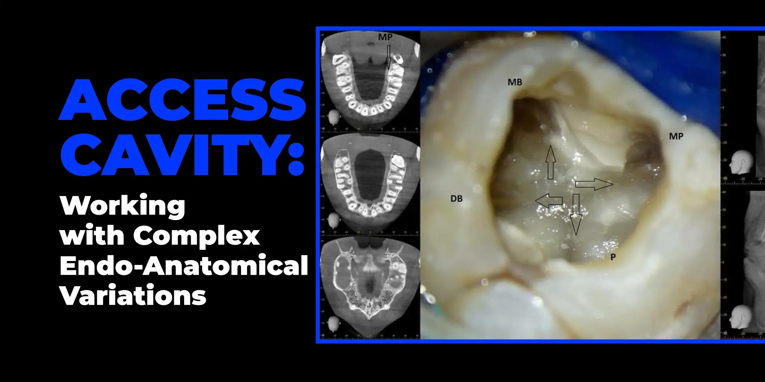 Microscopic Endodontic Anatomy and Its Clinical Implications
