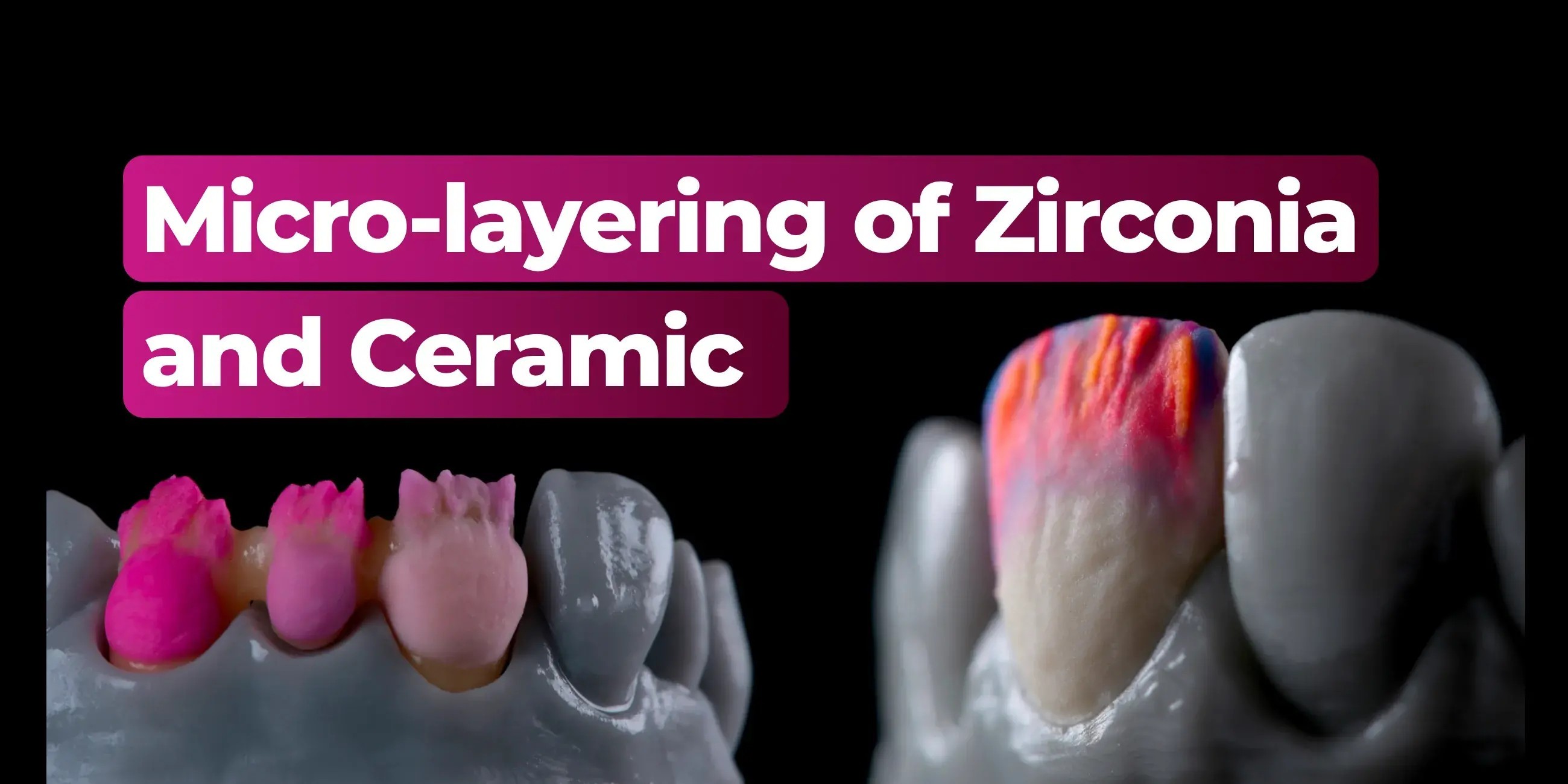 The Connection: Zirconia and Ceramic for Aesthetic Restorations