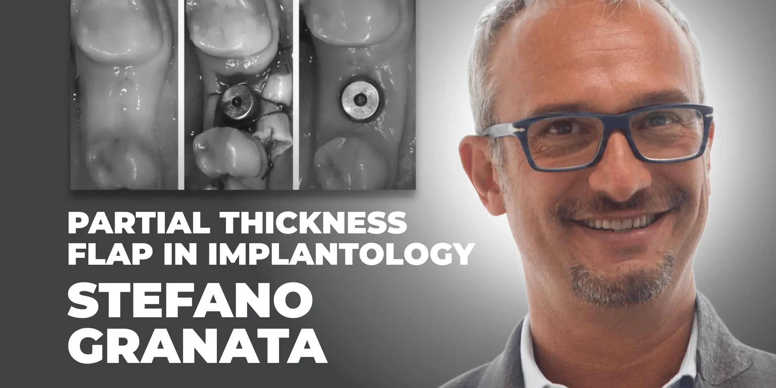 Partial Thickness Flap in Implantology: Different Surgical Perspectives