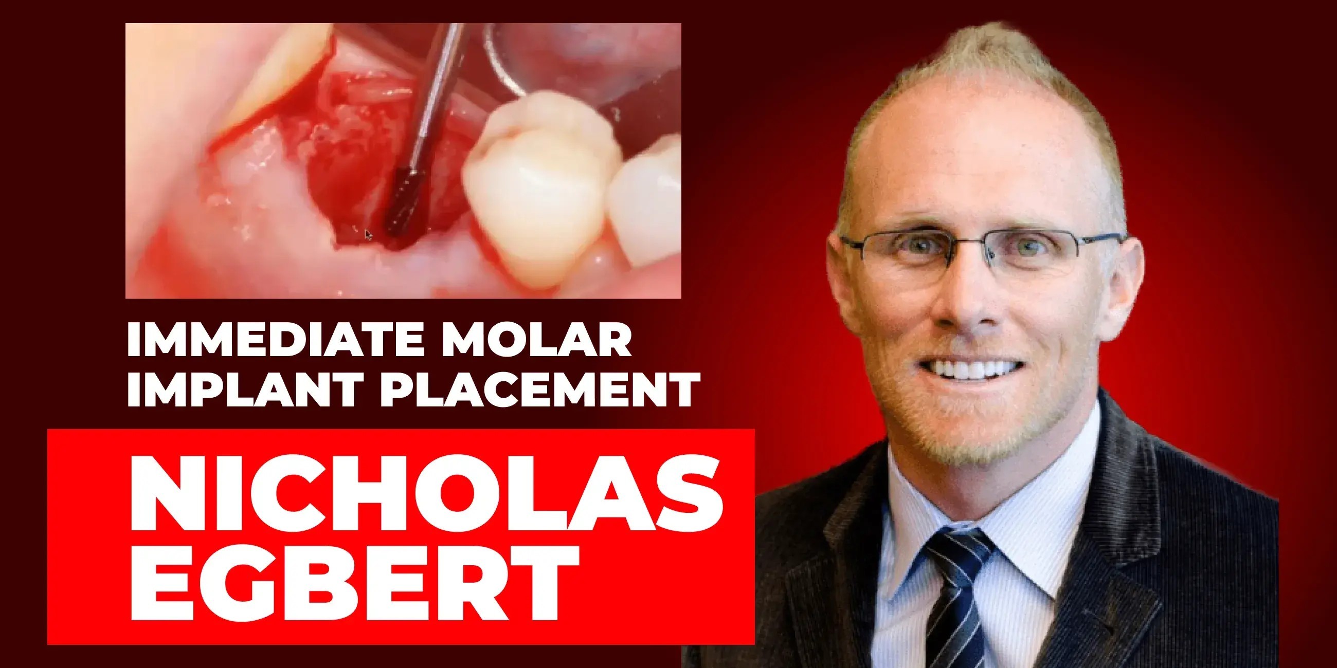 Immediate Molar Implant Placement: Techniques and Protocols