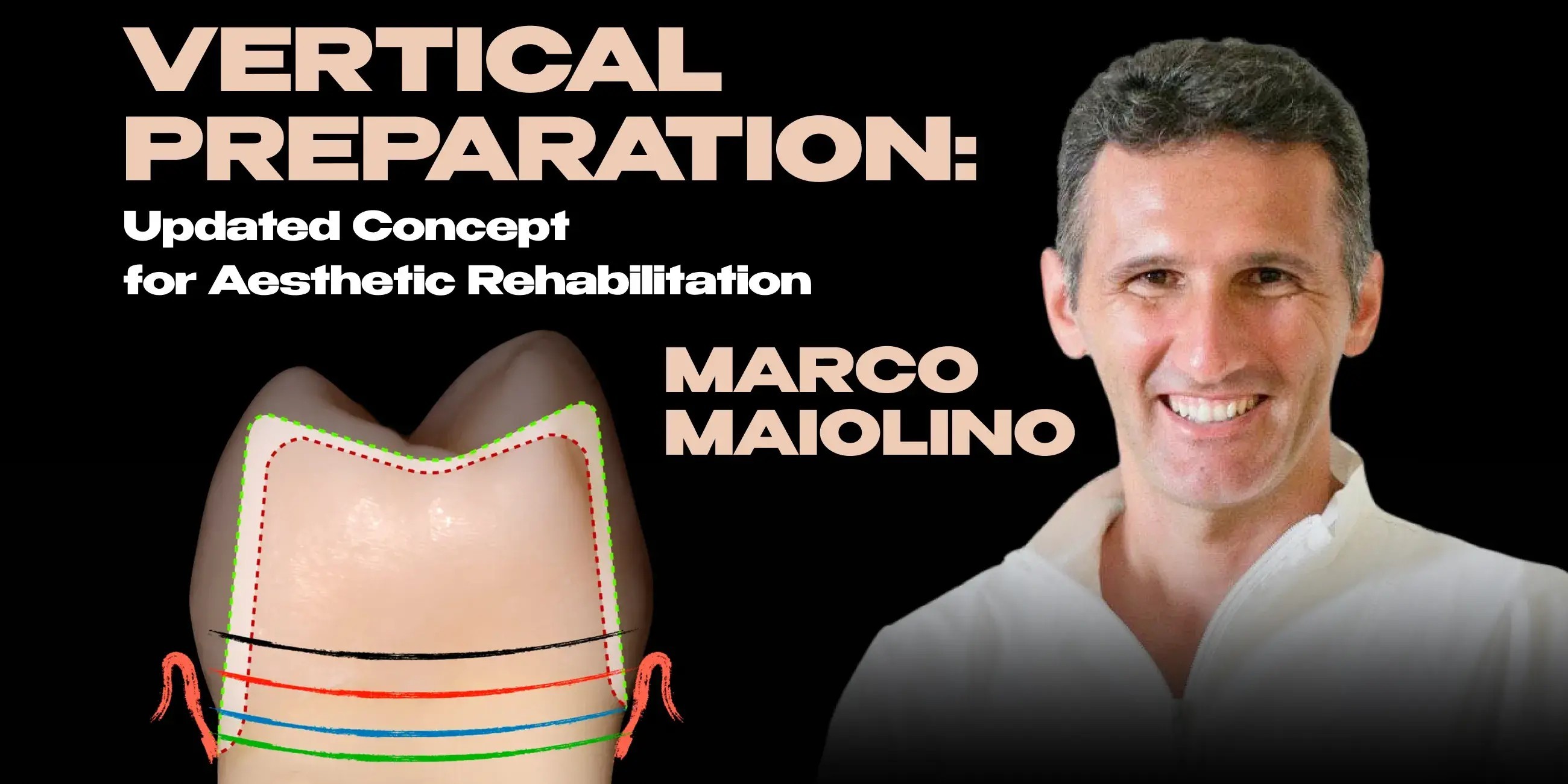Vertical Preparation: Clinical and Laboratory Protоcols: Dr Marco ...