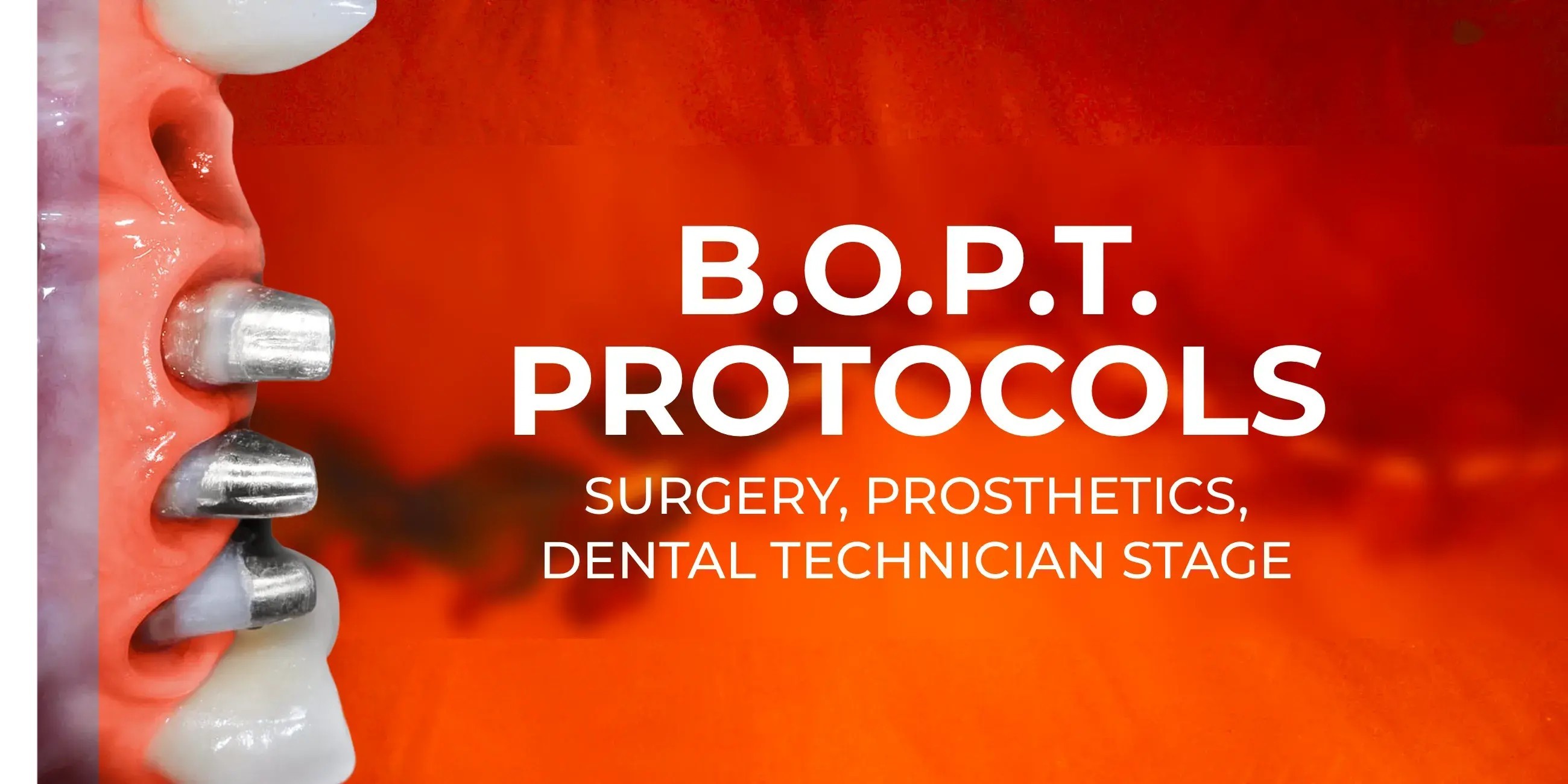 Webinar on BOPT on natural teeth, provisional restorations