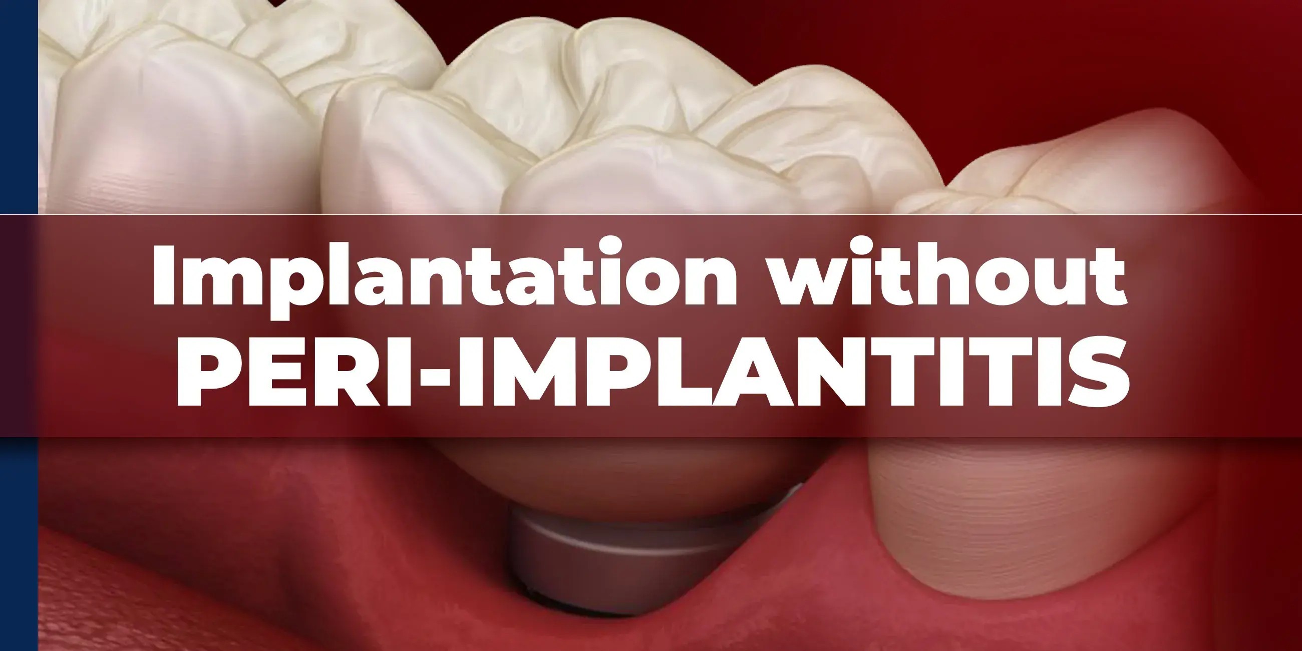 Webinar on peri-implant diseases, non-surgical treatment