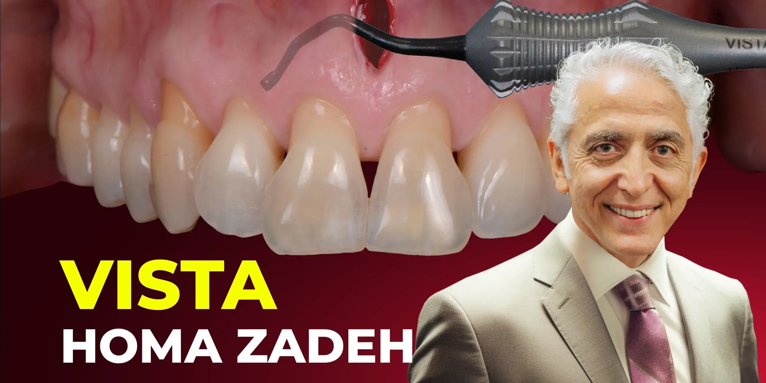 VISTA technique step-by-step protocol. Introductory lesson