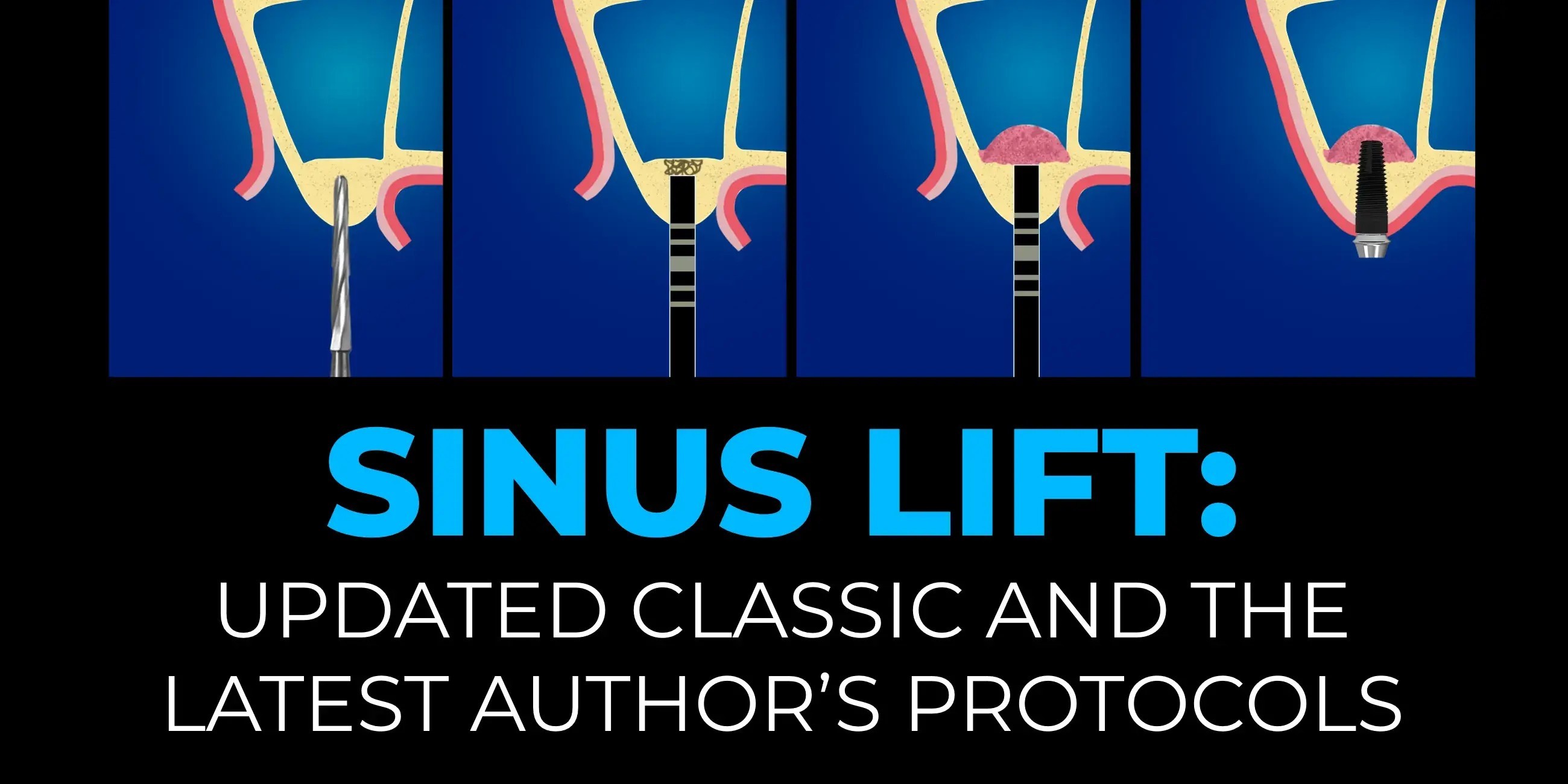 Sinus lift techniques: lateral and transcrestal approach, Intralift