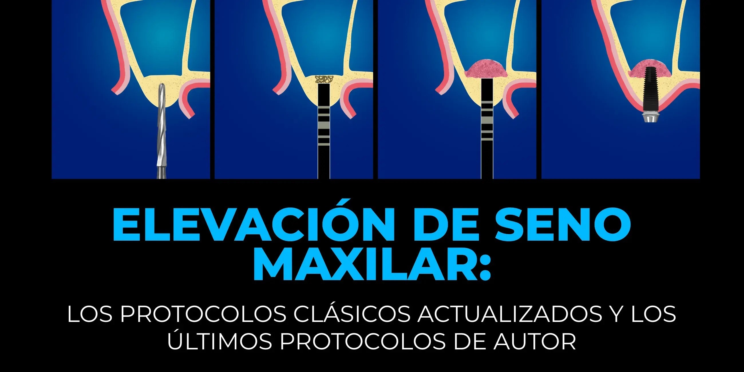 Elevación de seno maxilar: técnica transalveolar (osteotomo)