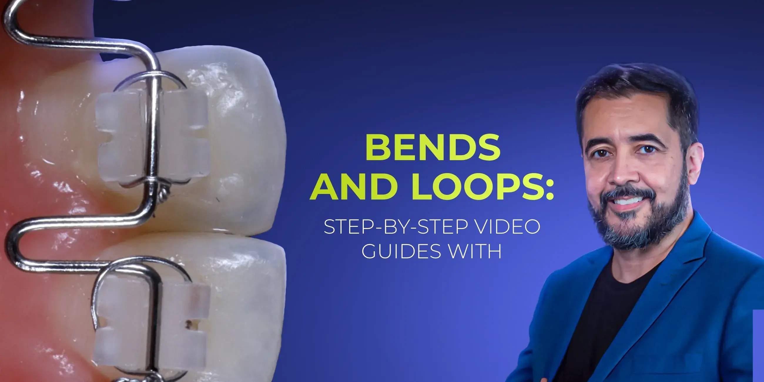 Leveling and Alignment Loops: Powerful Tools for Orthodontic Refinement ...