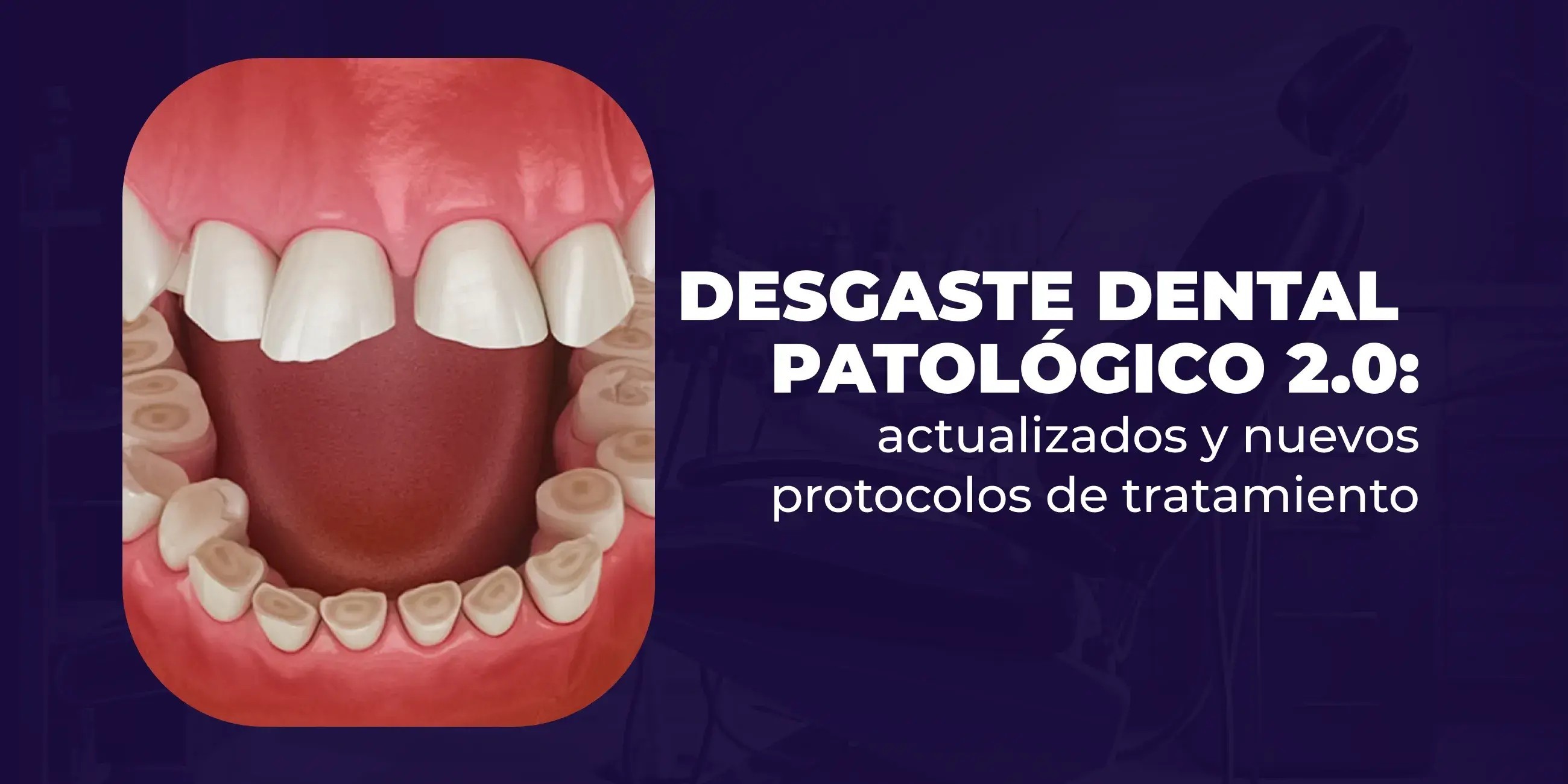 Sonrisa gingival y síndrome del diente corto: rehabilitación estética ...