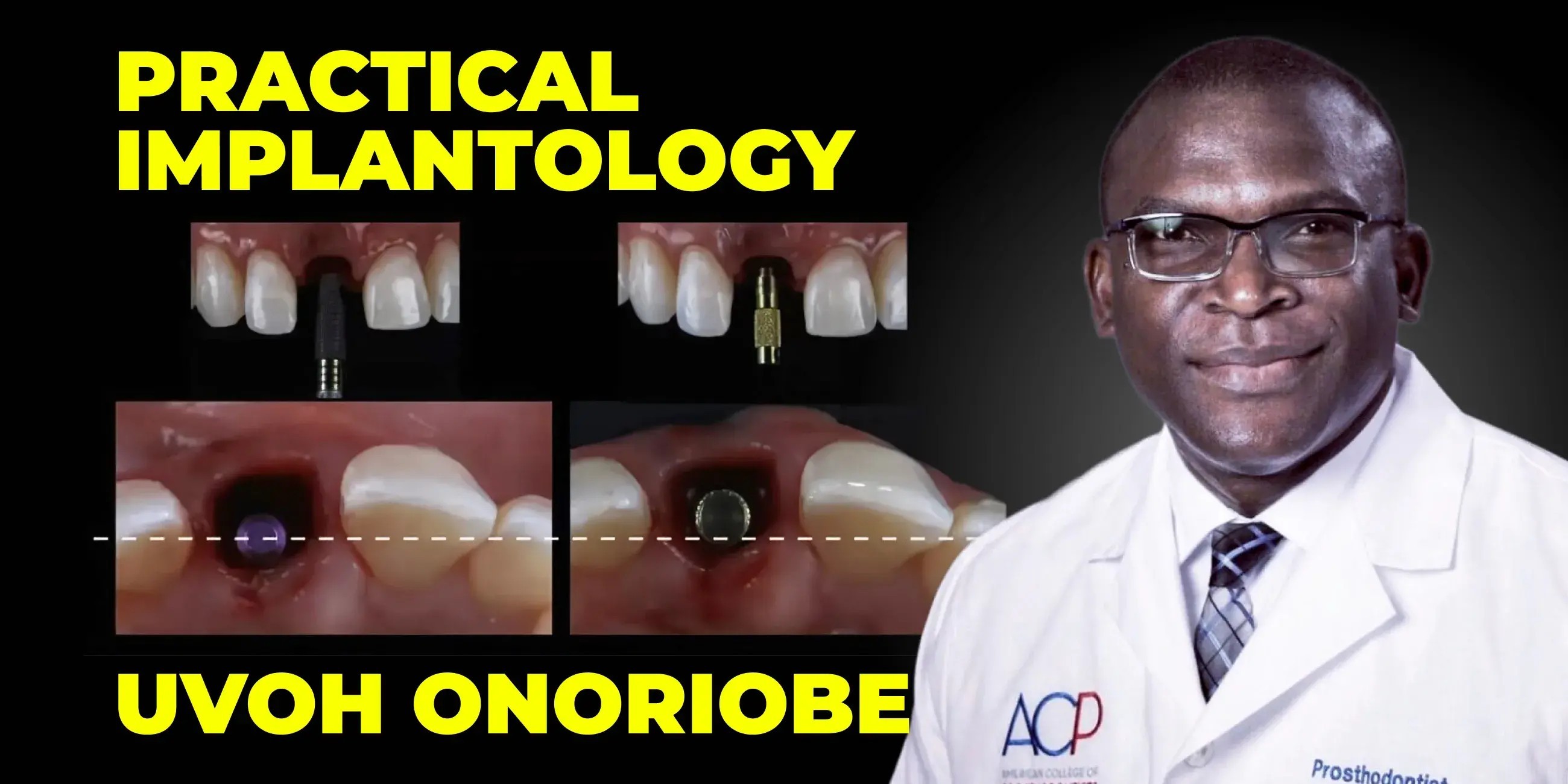 Full Rehabilitation Strategies for the Edentulous Maxilla Using Implants
